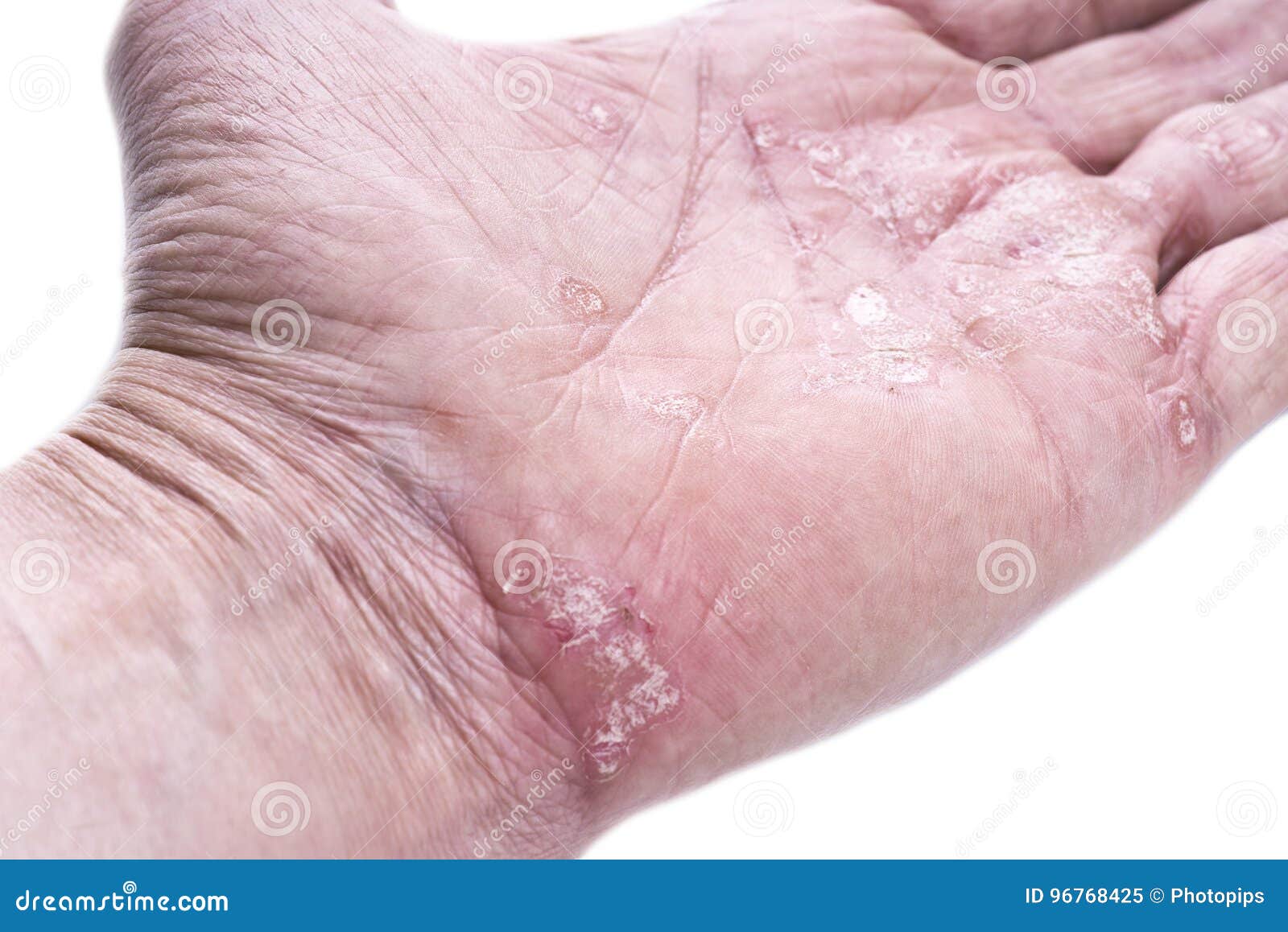 Psoriasis, Maladie De La Peau Image stock - Image du piquage, épiderme ...