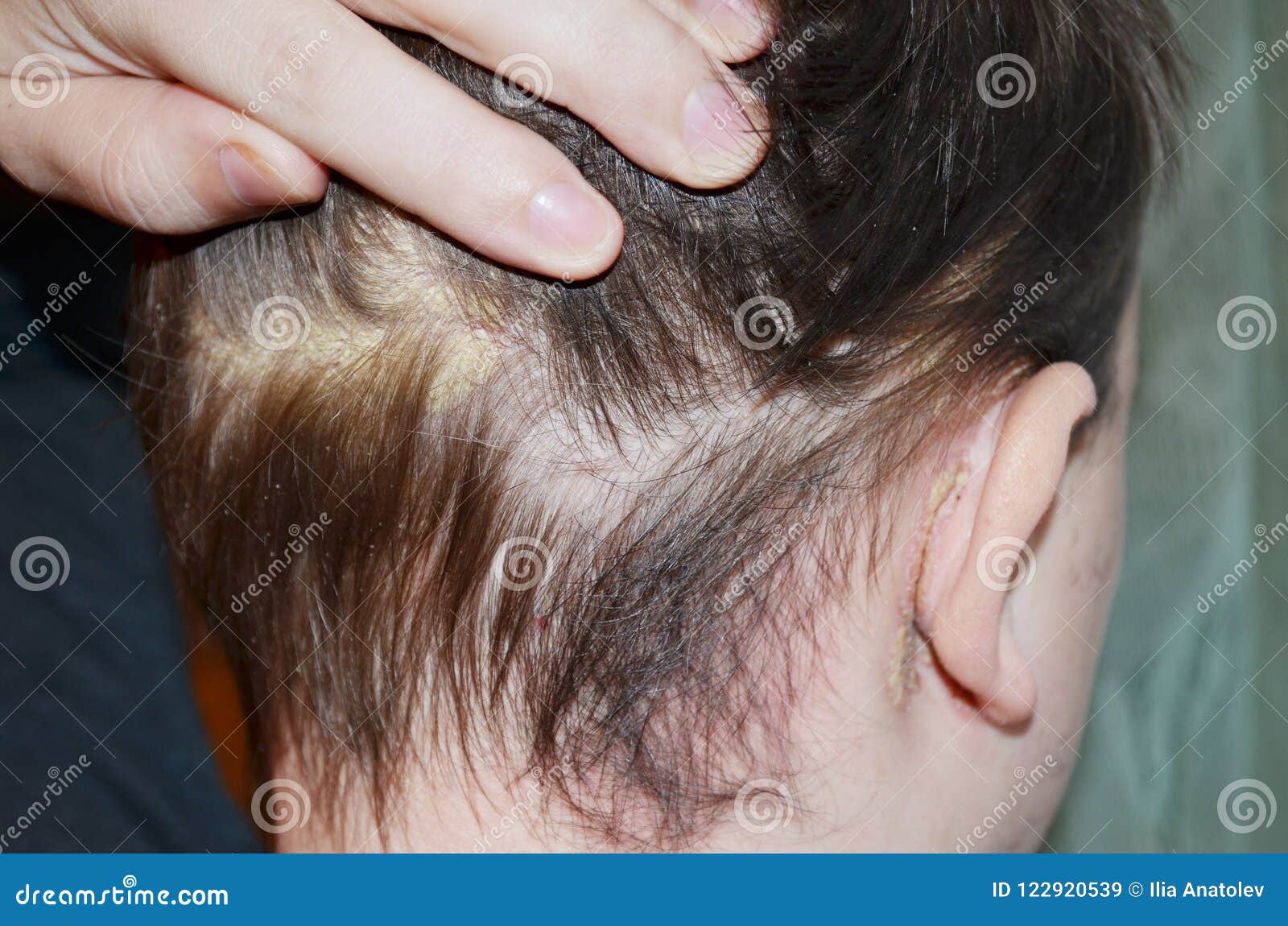 Psoriasis on the Nape, Eczema, Dermatology, Skin Problems Stock Image ...