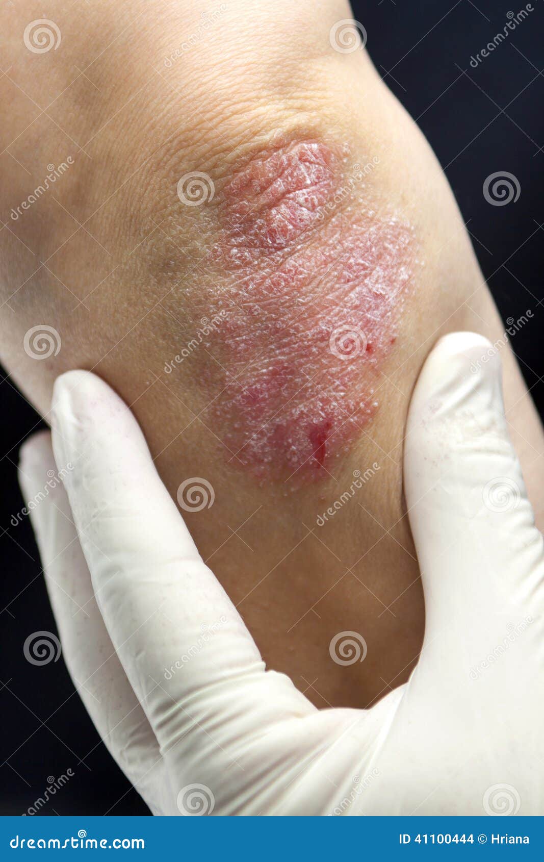 Psoriasis op ellebogen stock foto. Image of zwart, dermatitis - 41100444