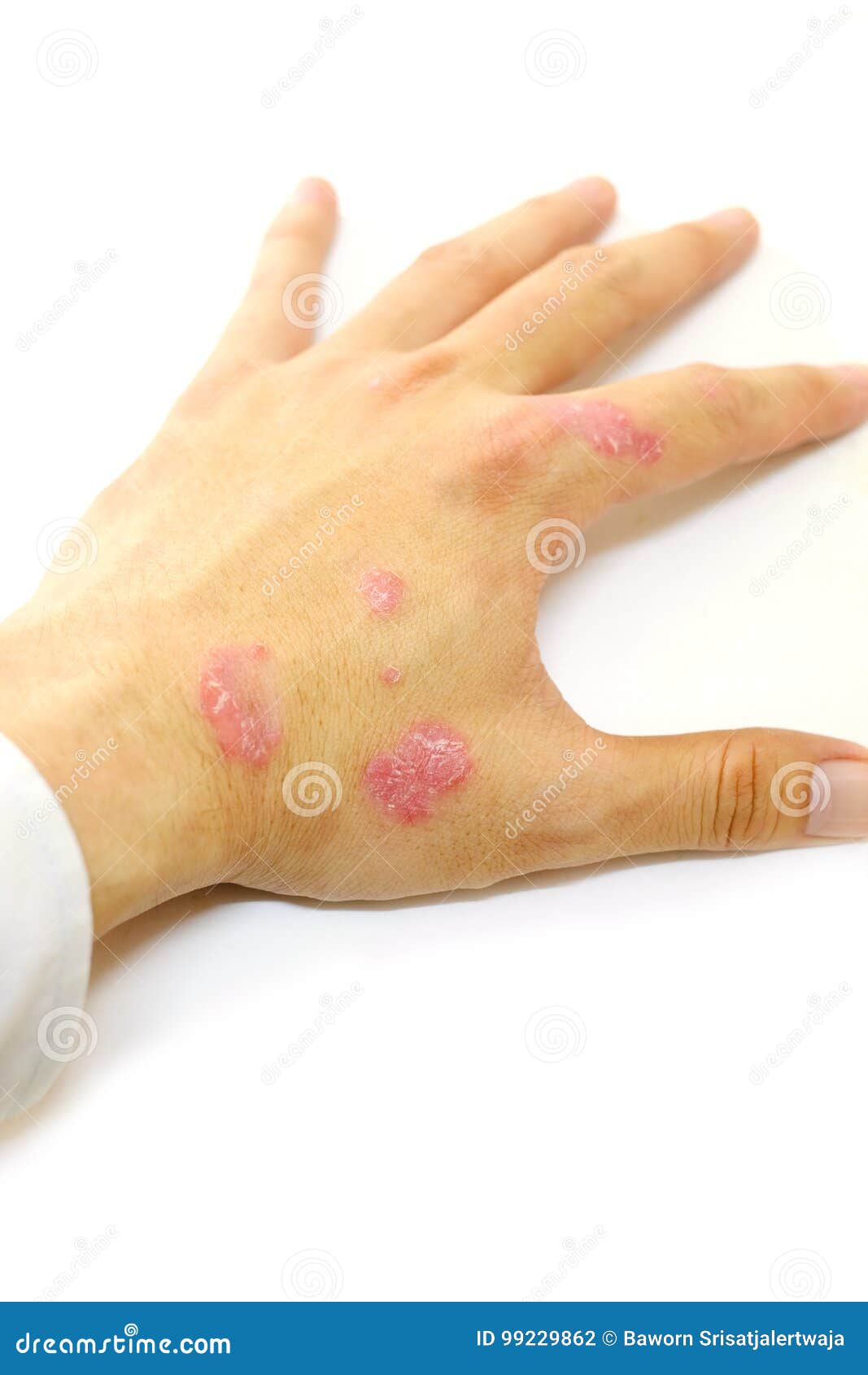Psoriasis stock photo. Image of scales, illness, medicine - 99229862