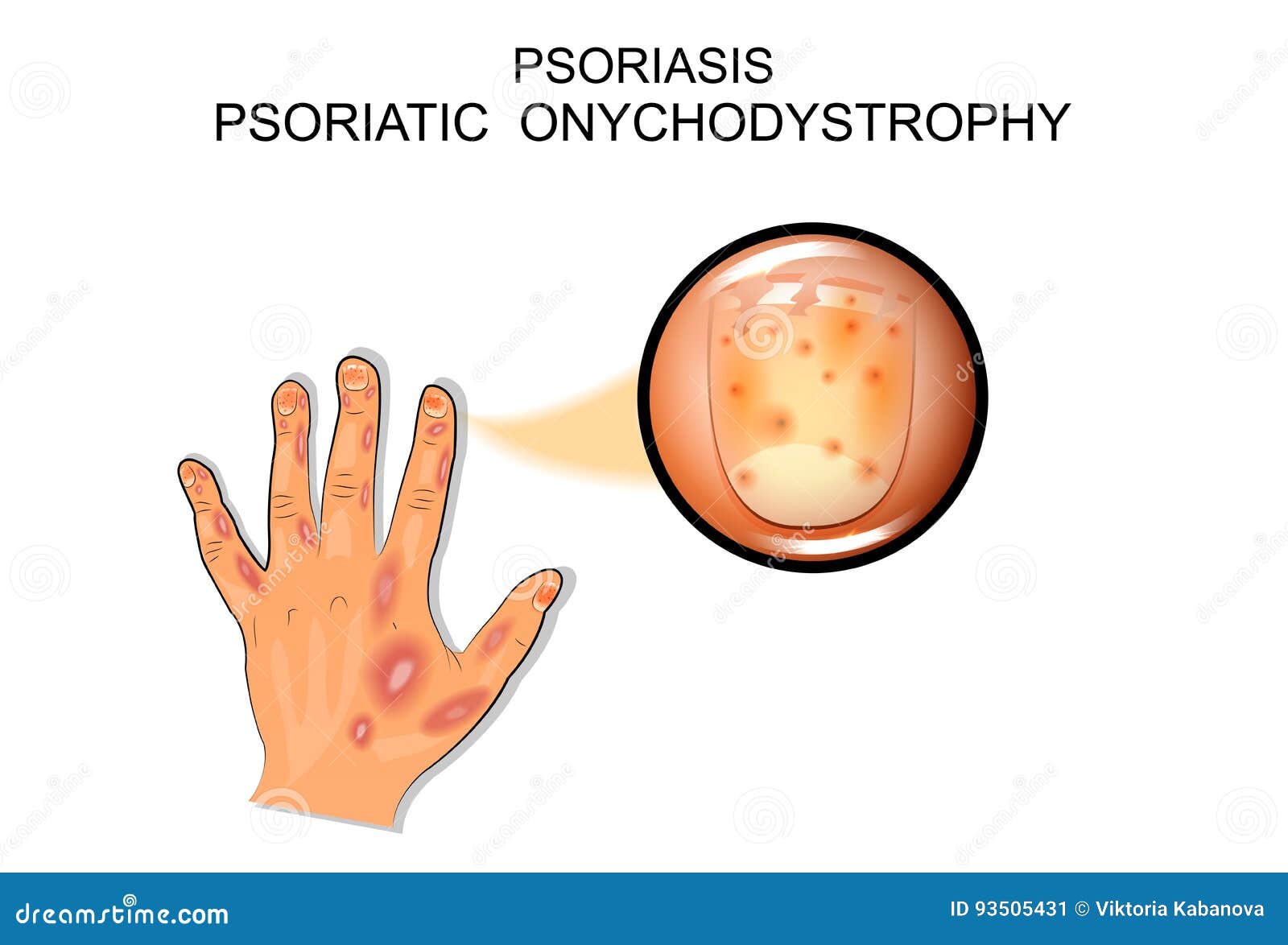 Psoriasis. Psoriatic Onychodystrophy Cartoon Vector | CartoonDealer.com ...