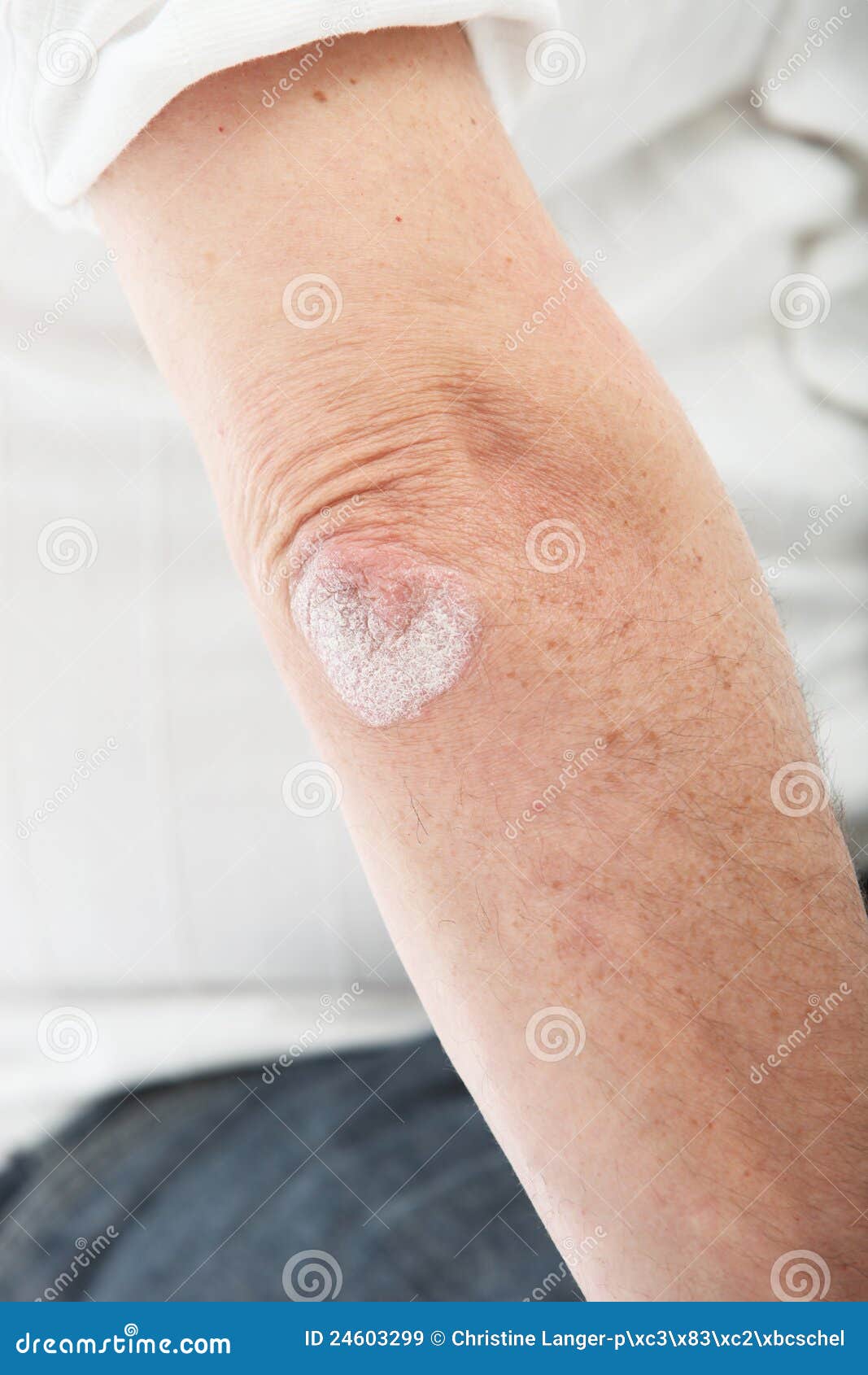 Eczema On Elbows