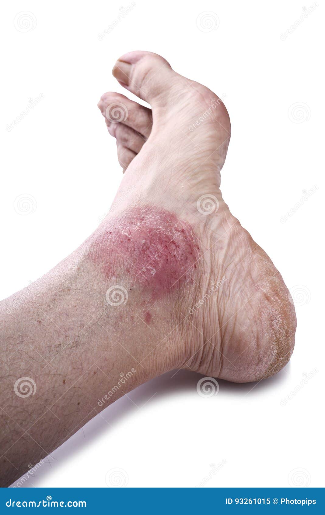 Gross Skin Diseases