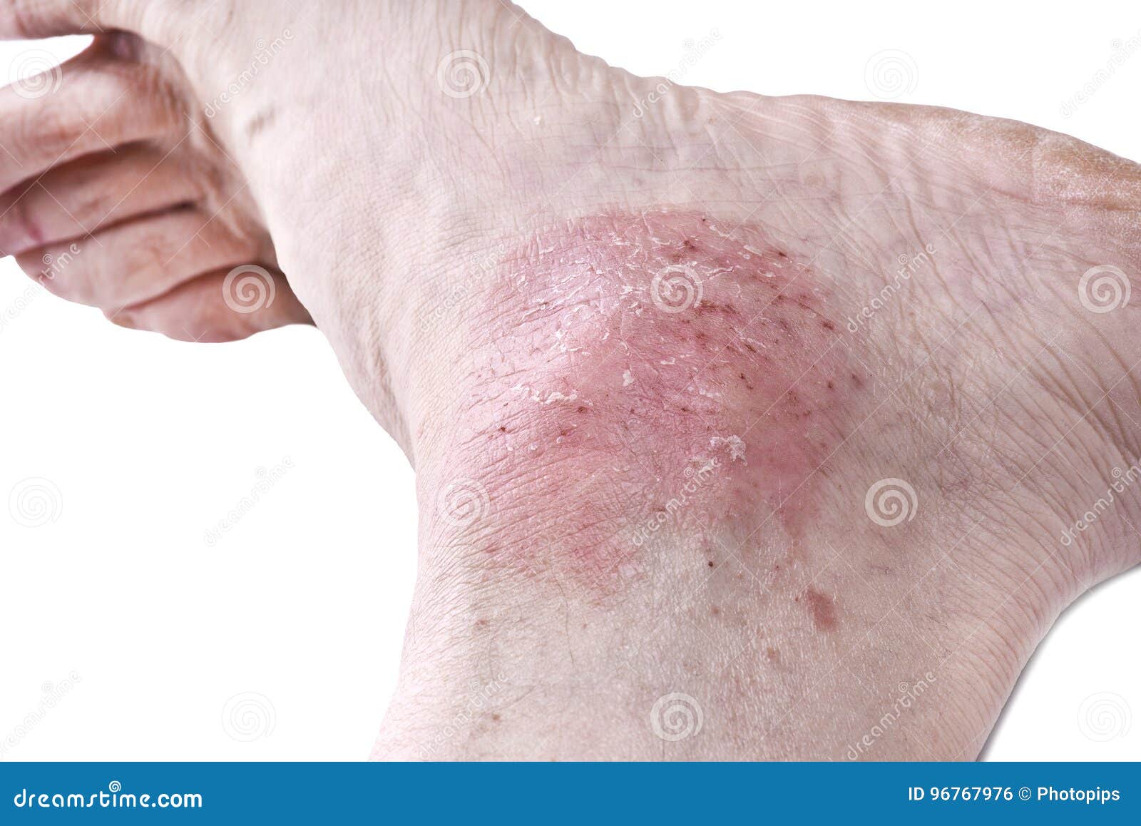 Psoriasis, skin disease stock photo. Image of ankle, joints - 96767976