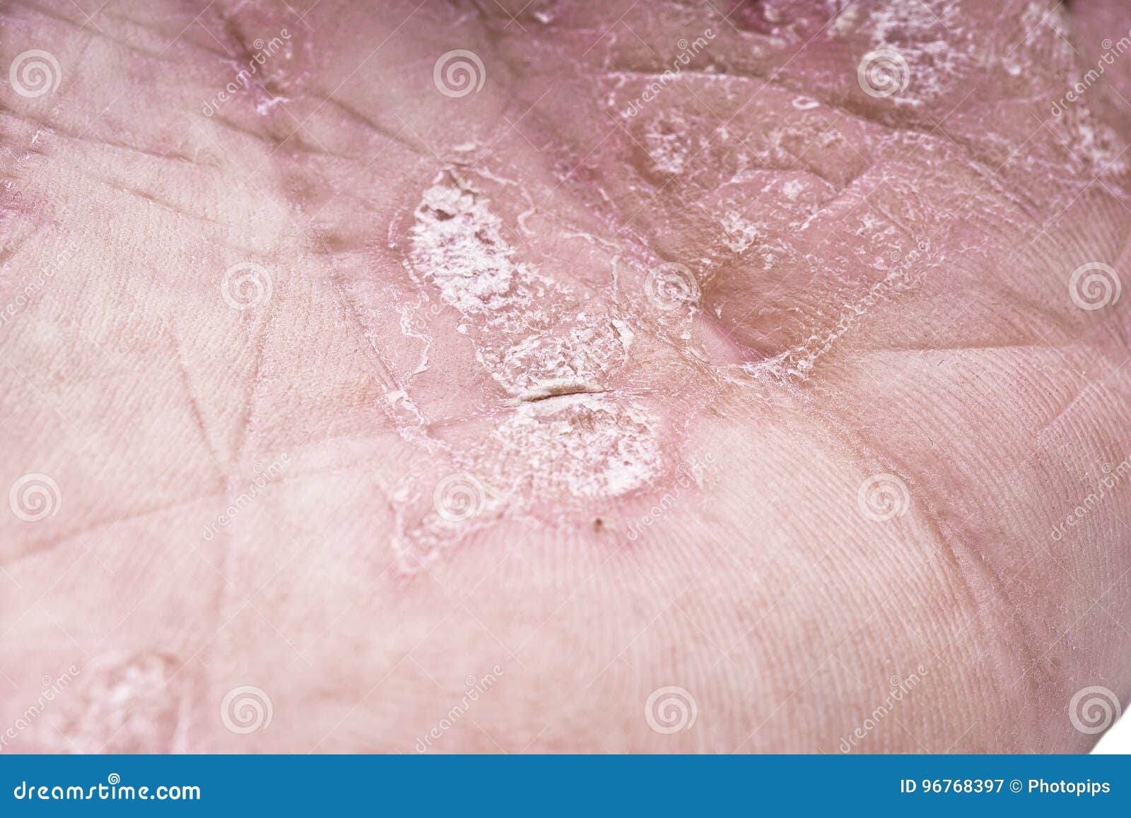 Psoriasis, skin disease stock image. Image of infection - 96768397