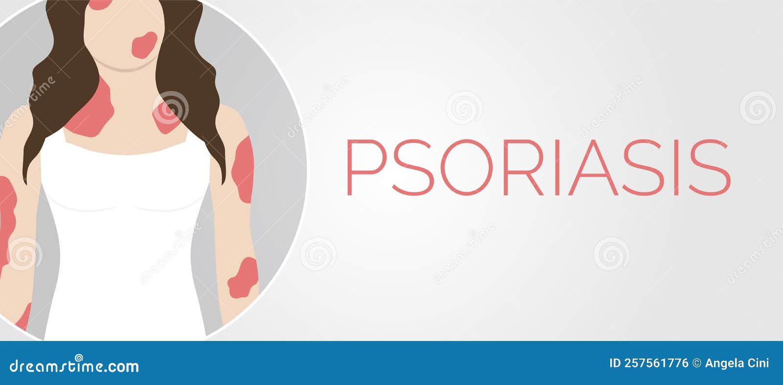 Psoriasis Skin Disease Or Illness Dermatology Vector Illustration ...