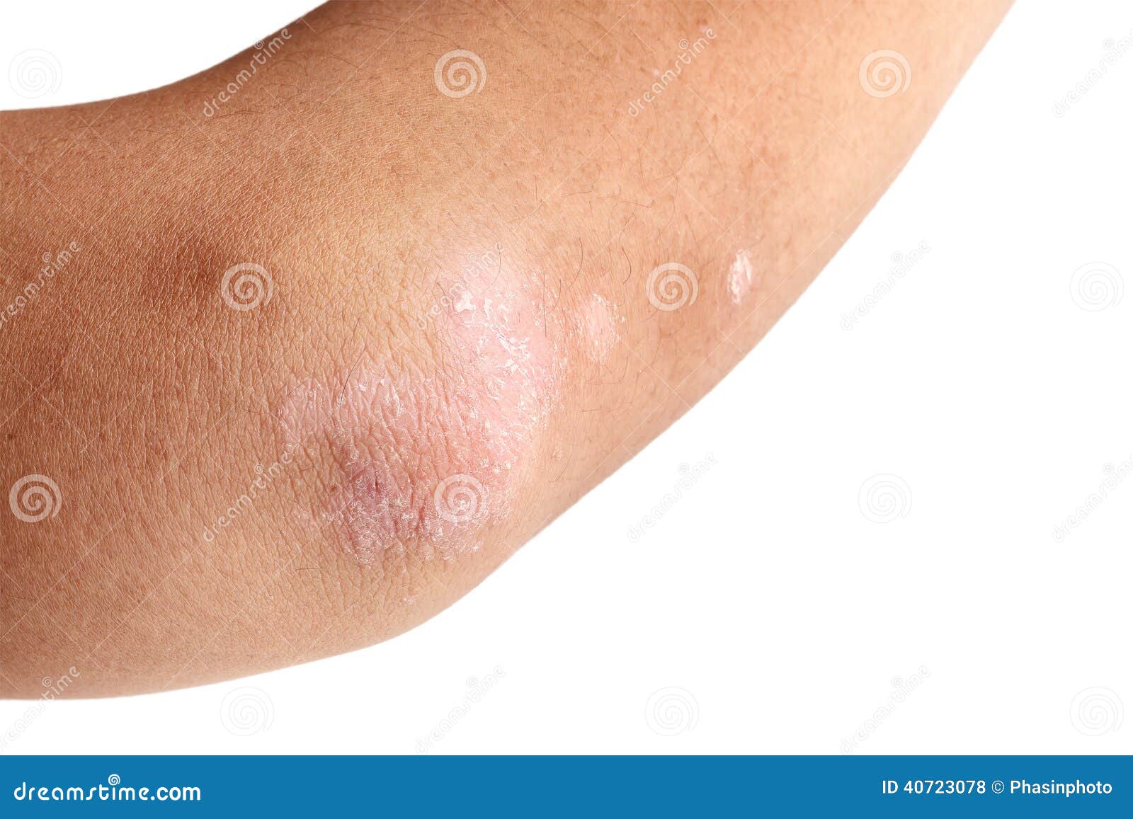 Psoriasis sur le bras photo stock. Image du écaillement - 40723078