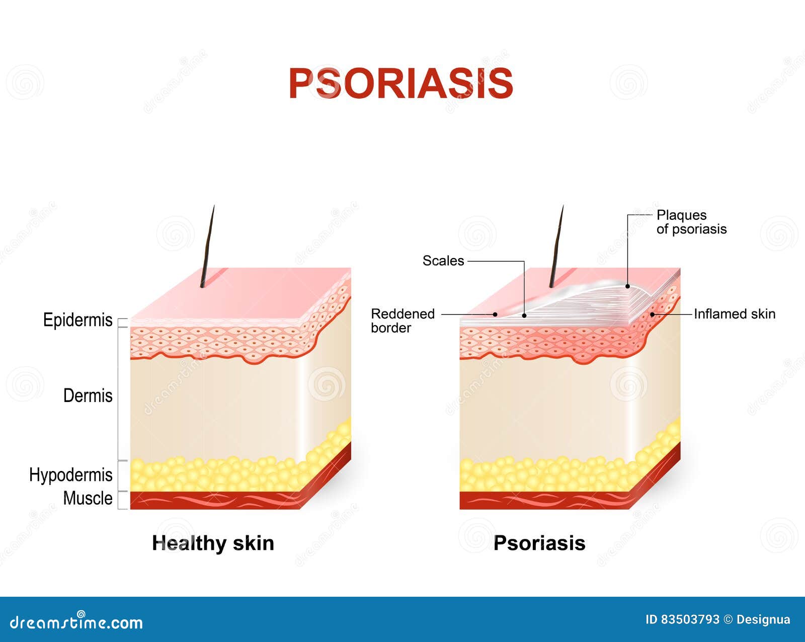 Psoriasis stock vector. Illustration of disorder, patient - 83503793