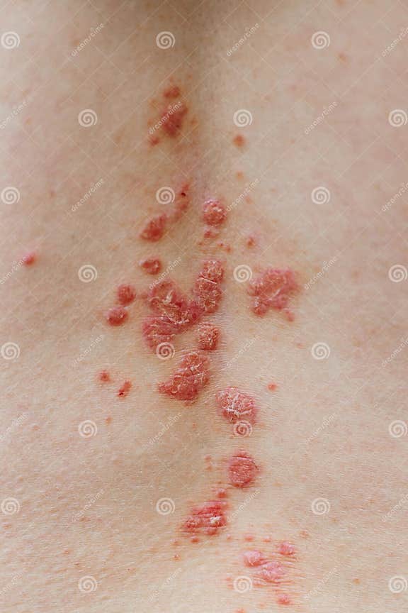 Psoriasis Vulgaris Skin Psoriasis Is An Autoimmune Disease That
