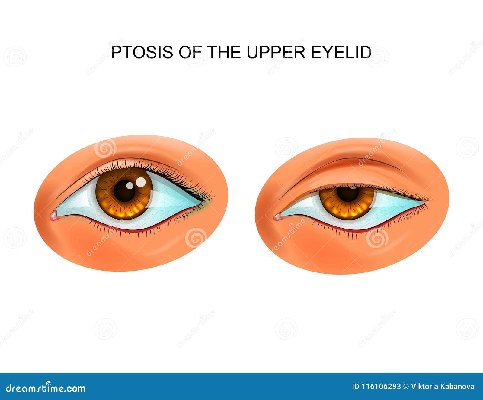 Ptosis van het ooglid vector illustratie. Illustration of allergisch ...