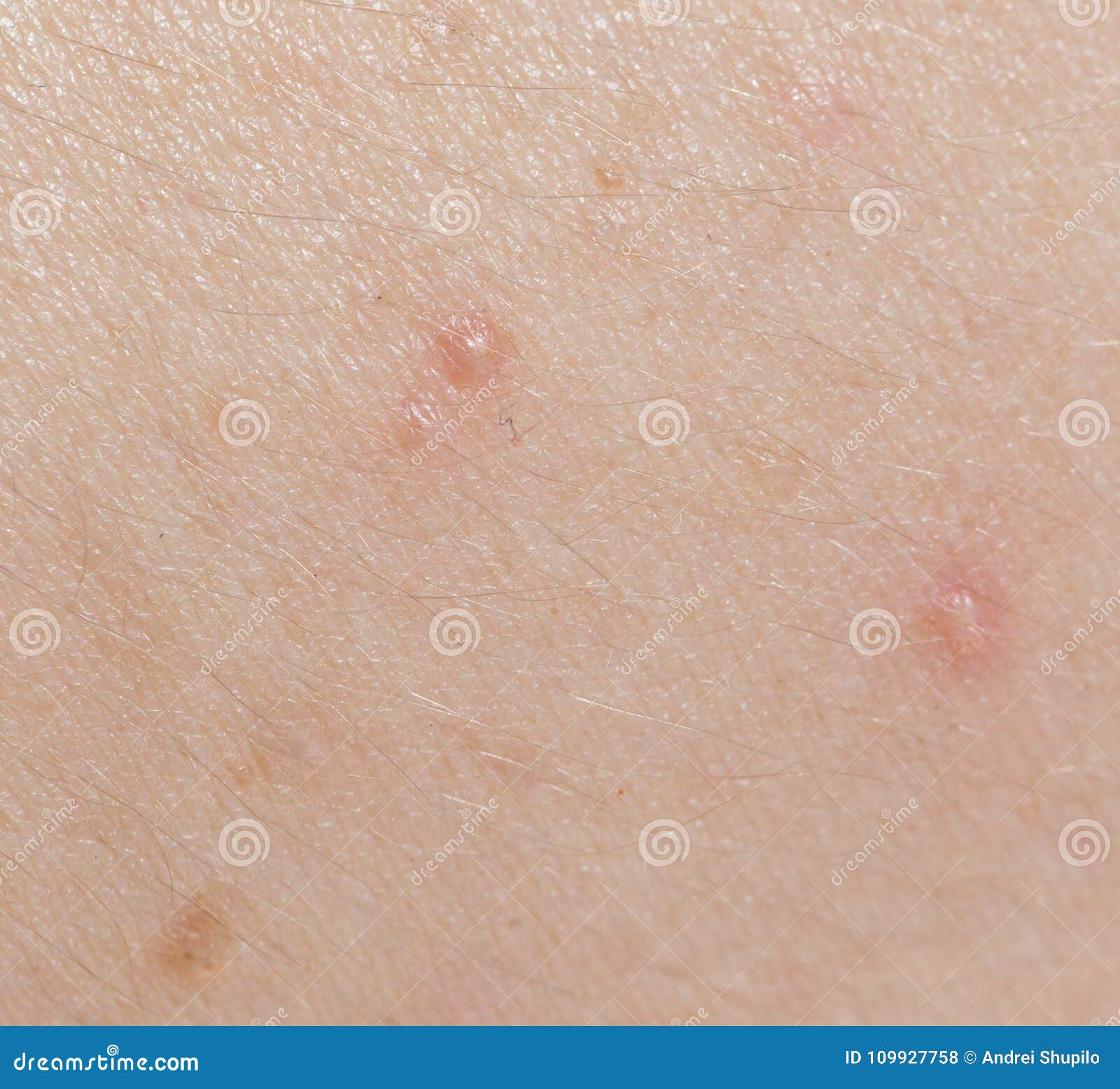 Pukkels op de huid sluit stock foto. Image of huid, macro - 109927758