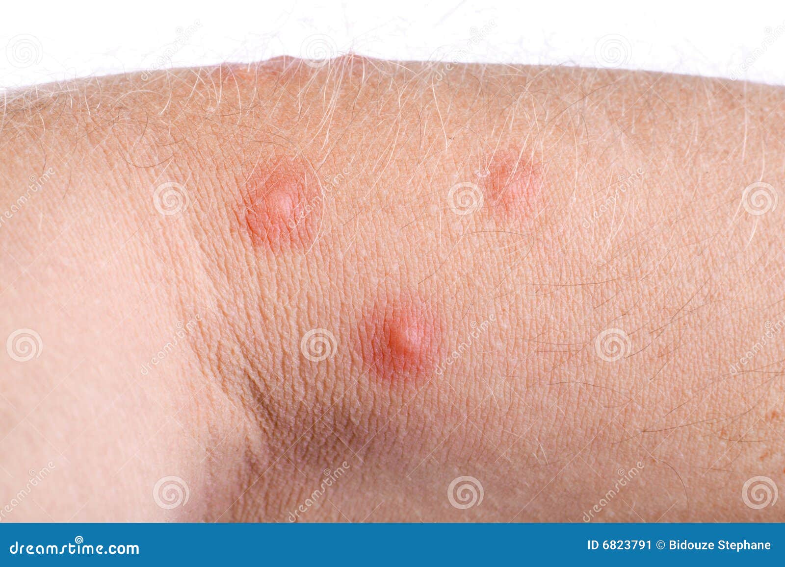 Pukkels op huid stock afbeelding. Image of allergie, giftig - 6823791