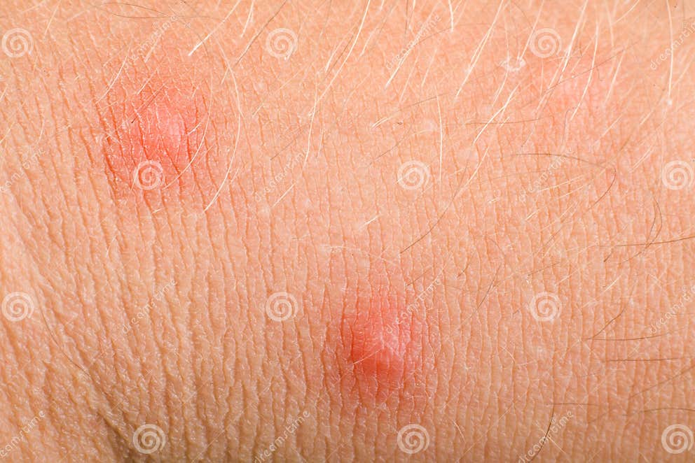 Pukkels op huid stock foto. Image of vlek, poster, medisch - 6823860