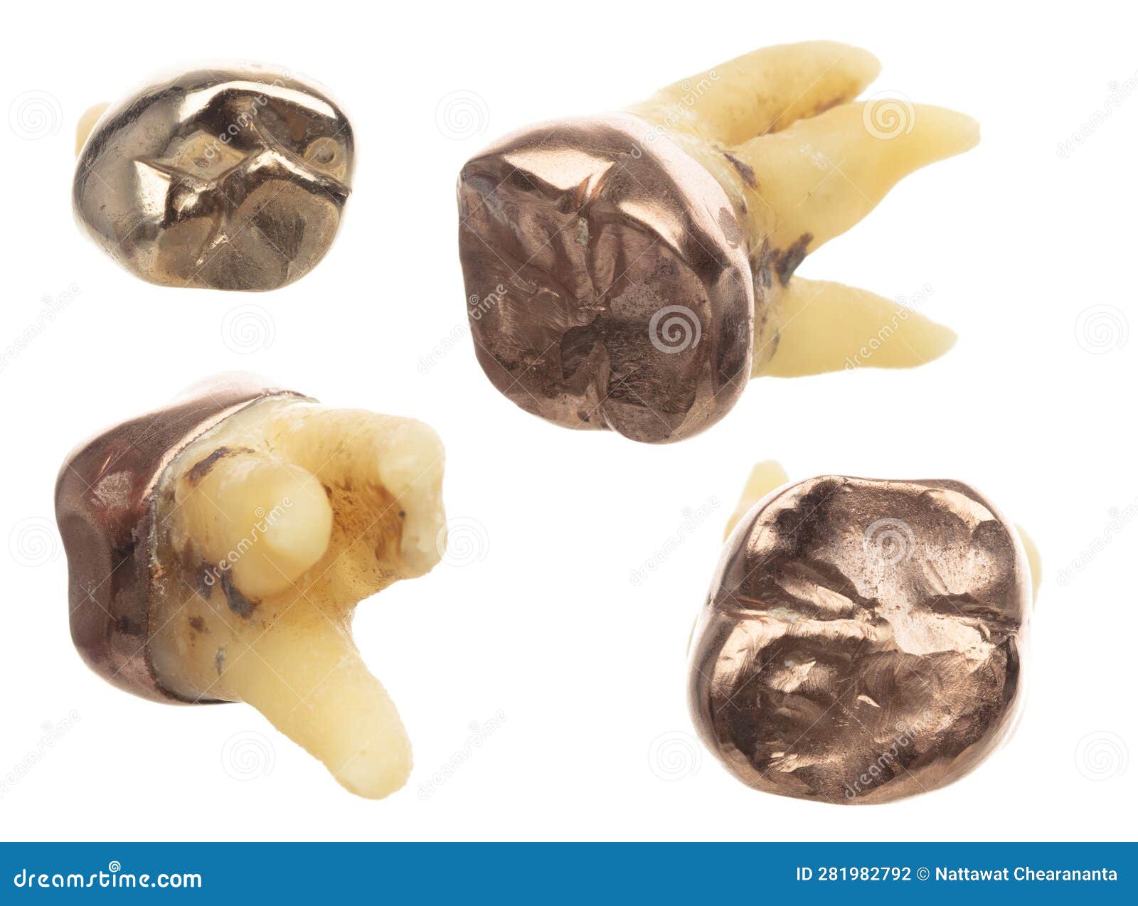 Pulled Molar Tooth with Gold Crown To Show Many Angle, Advanced Caries ...