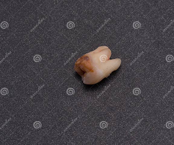 A Pulled Out Wisdom Tooth Third Molar on Grey Background Stock Photo ...
