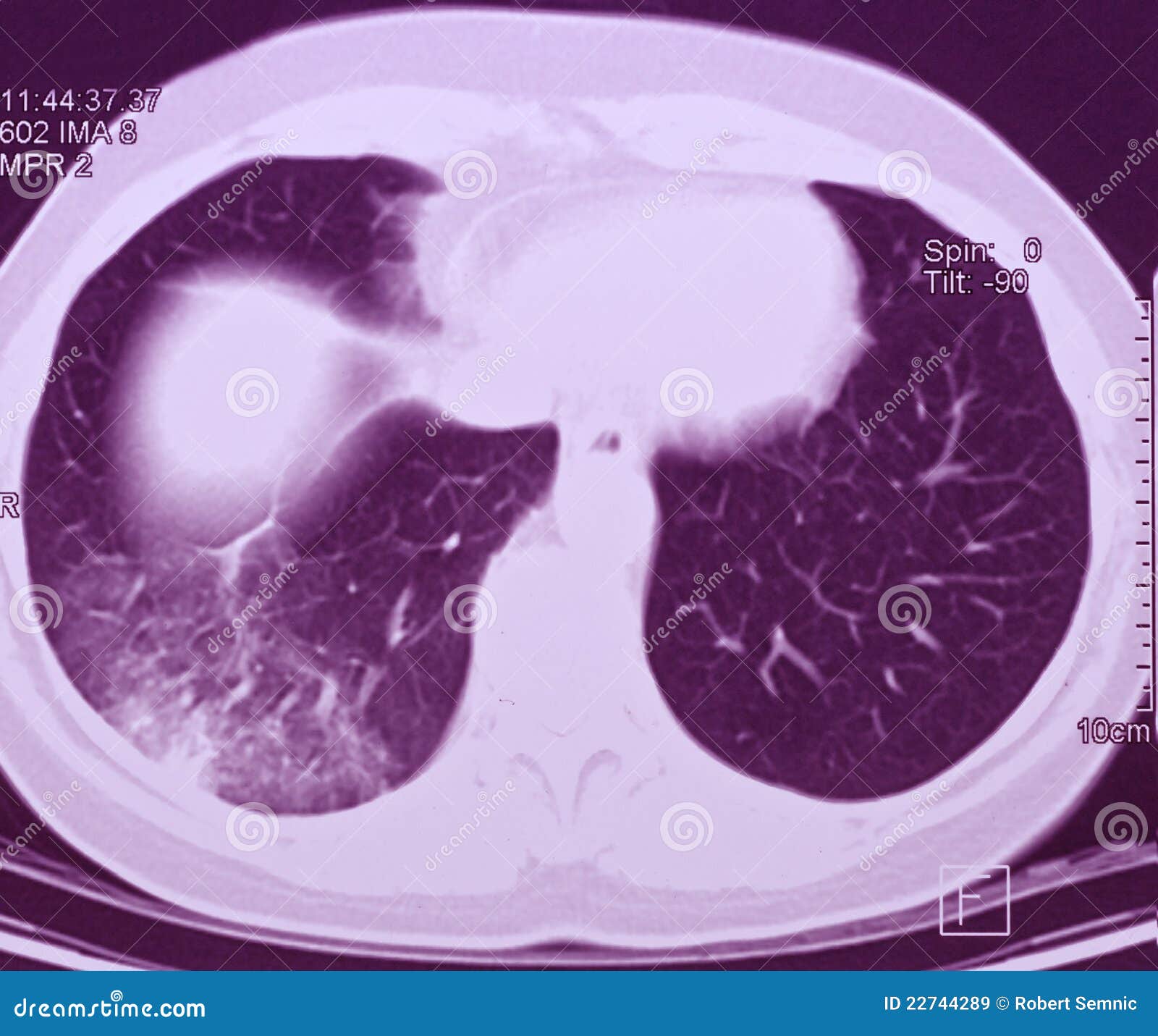 Pulmão CT, pneumonia imagem de stock. Imagem de milho - 22744289