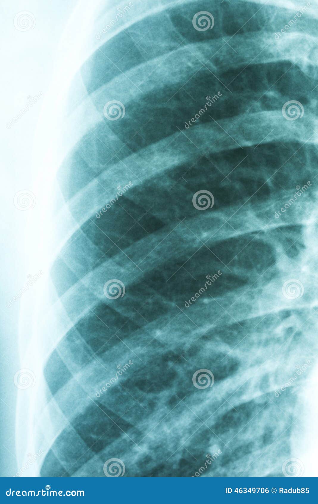 Pulmón infectado pulmonía foto de archivo. Imagen de asma - 46349706