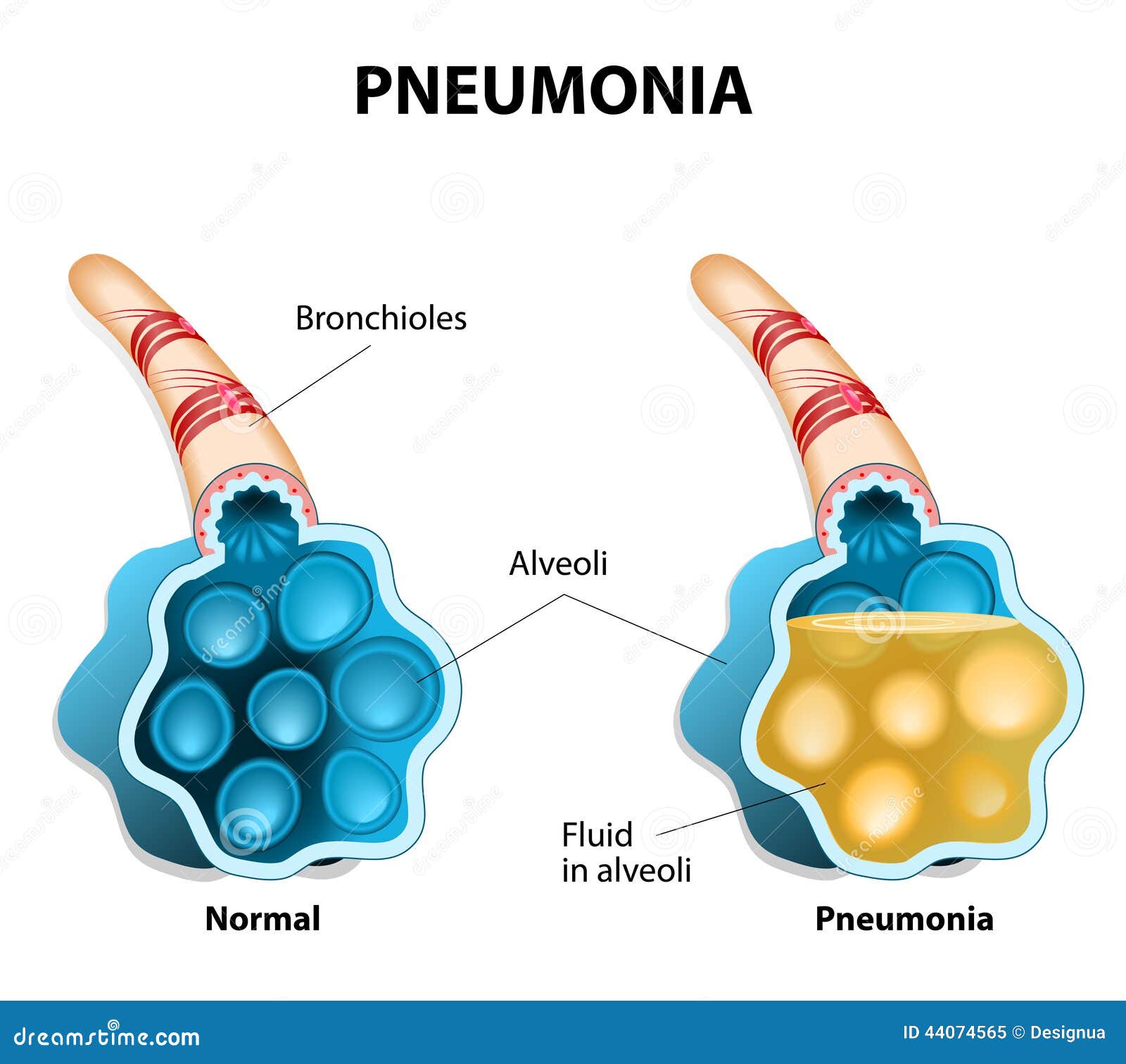 Pulmonía El Ejemplo Muestra Normal E Infectado Ilustración del Vector ...