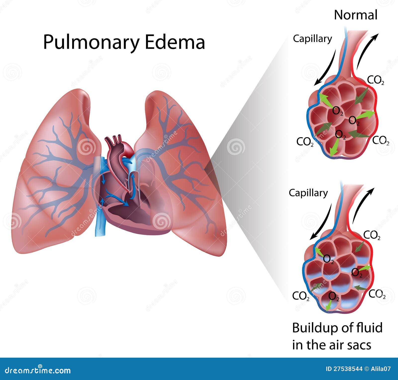 Pulmonary edema stock vector. Image of edema, blood, heart - 27538544