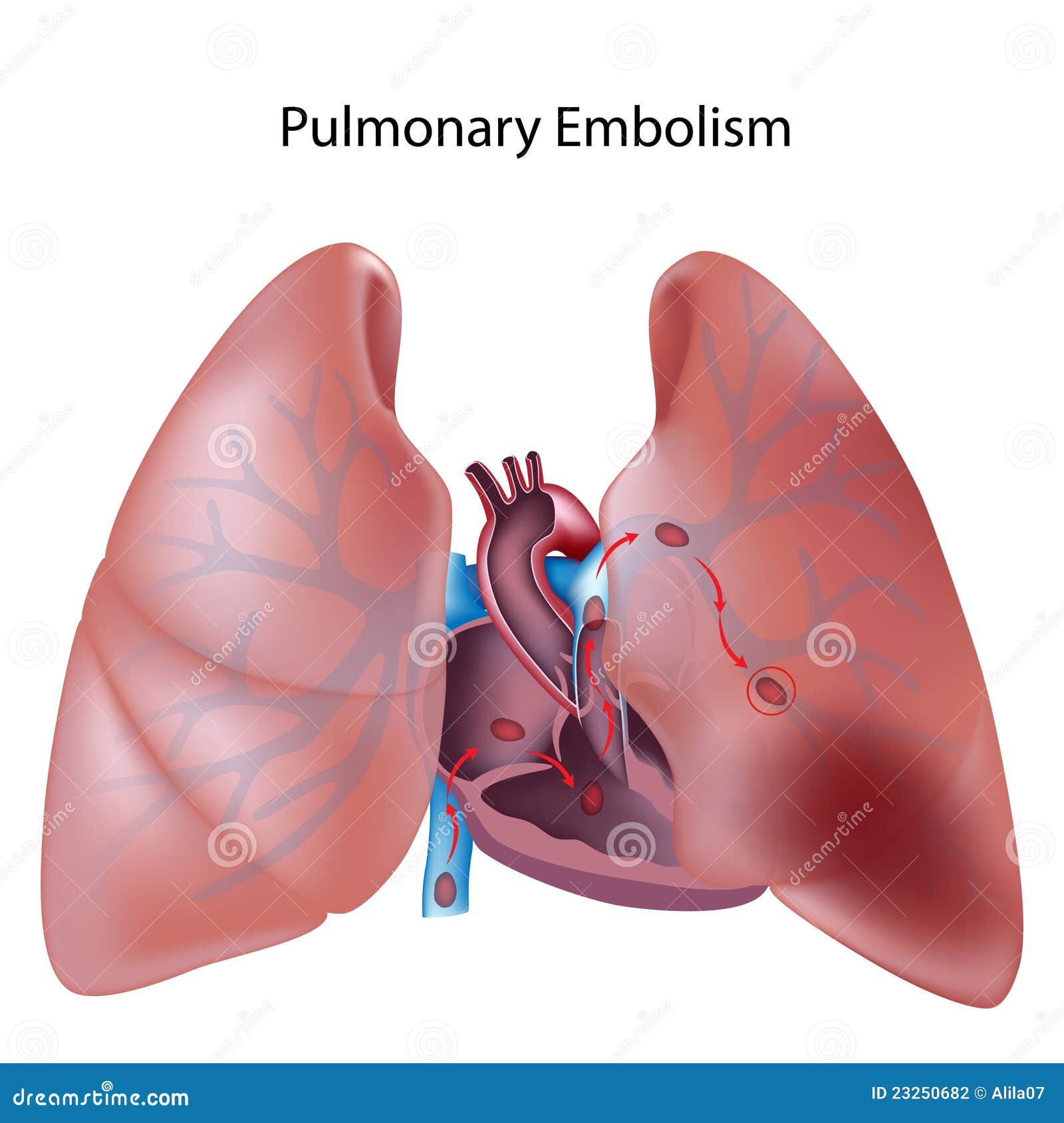 Pulmonary embolism stock vector. Illustration of infarction - 23250682