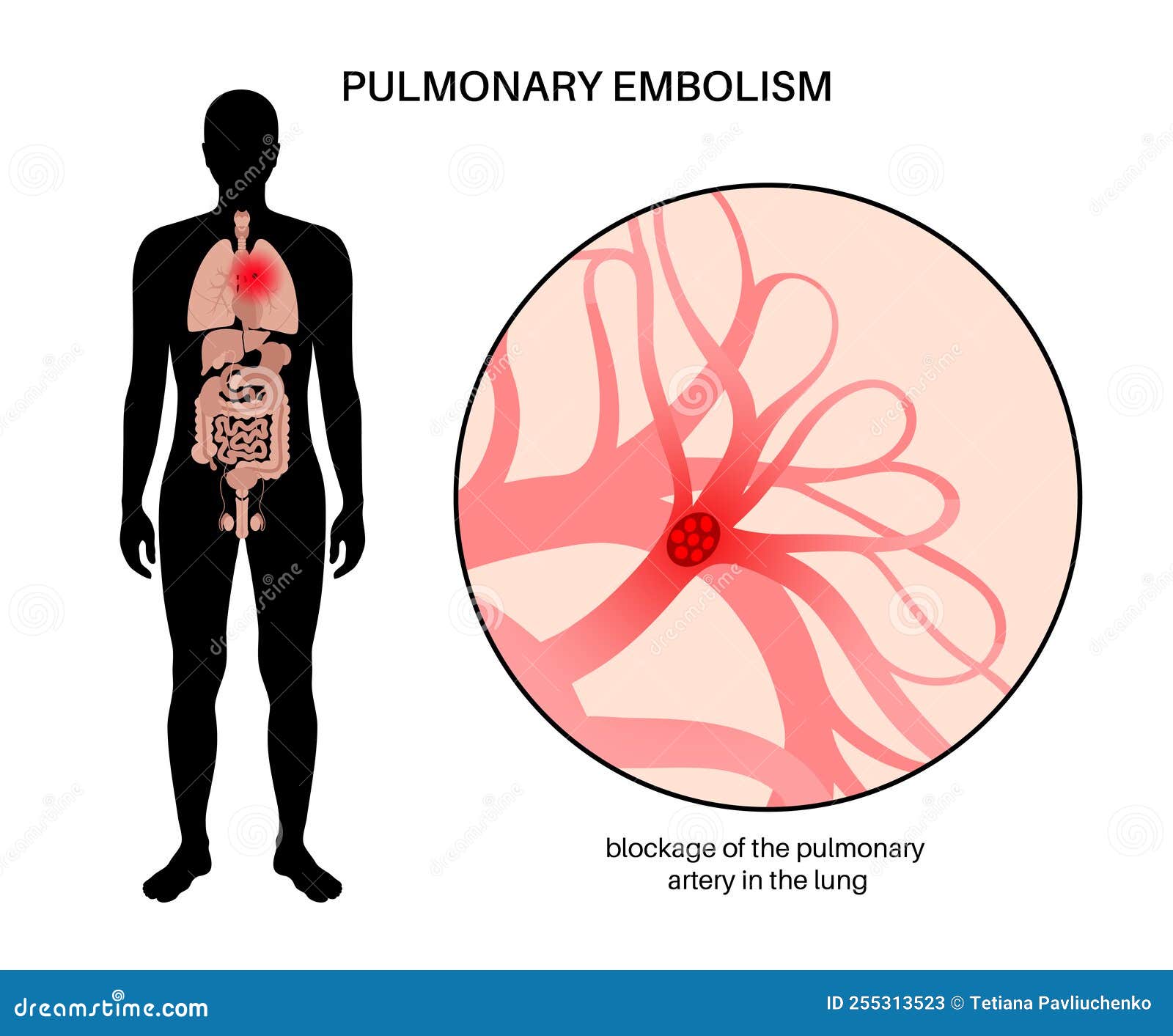 Pulmonary Embolism Disease Stock Vector Illustration Of Deep 255313523