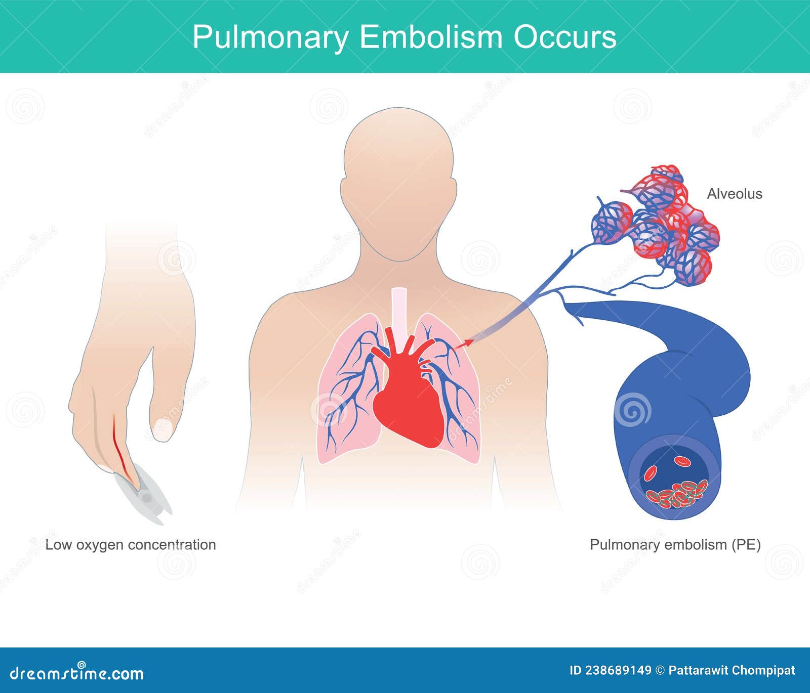 Pulmonary Embolism Occurs Stock Vector Illustration Of Anatomy 238689149