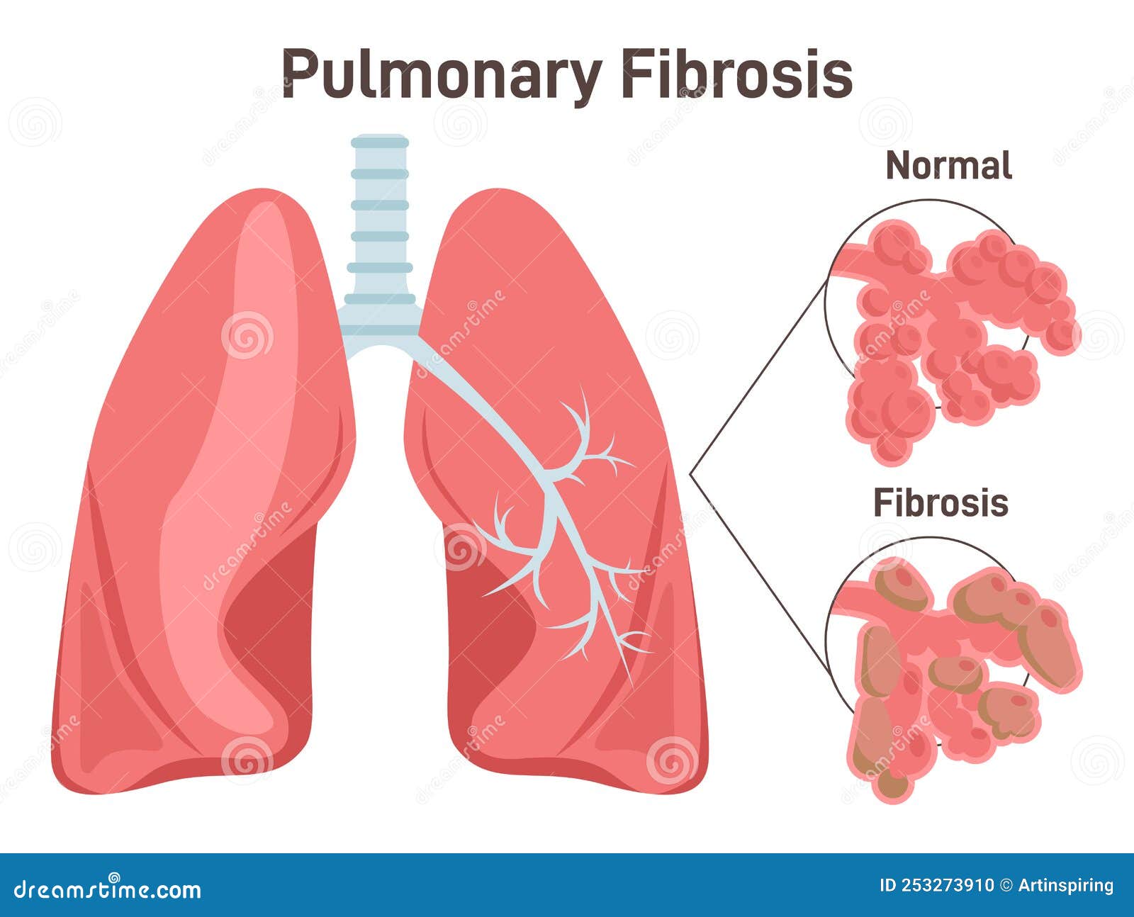 Cystic Fibrosis Lungs Diagram