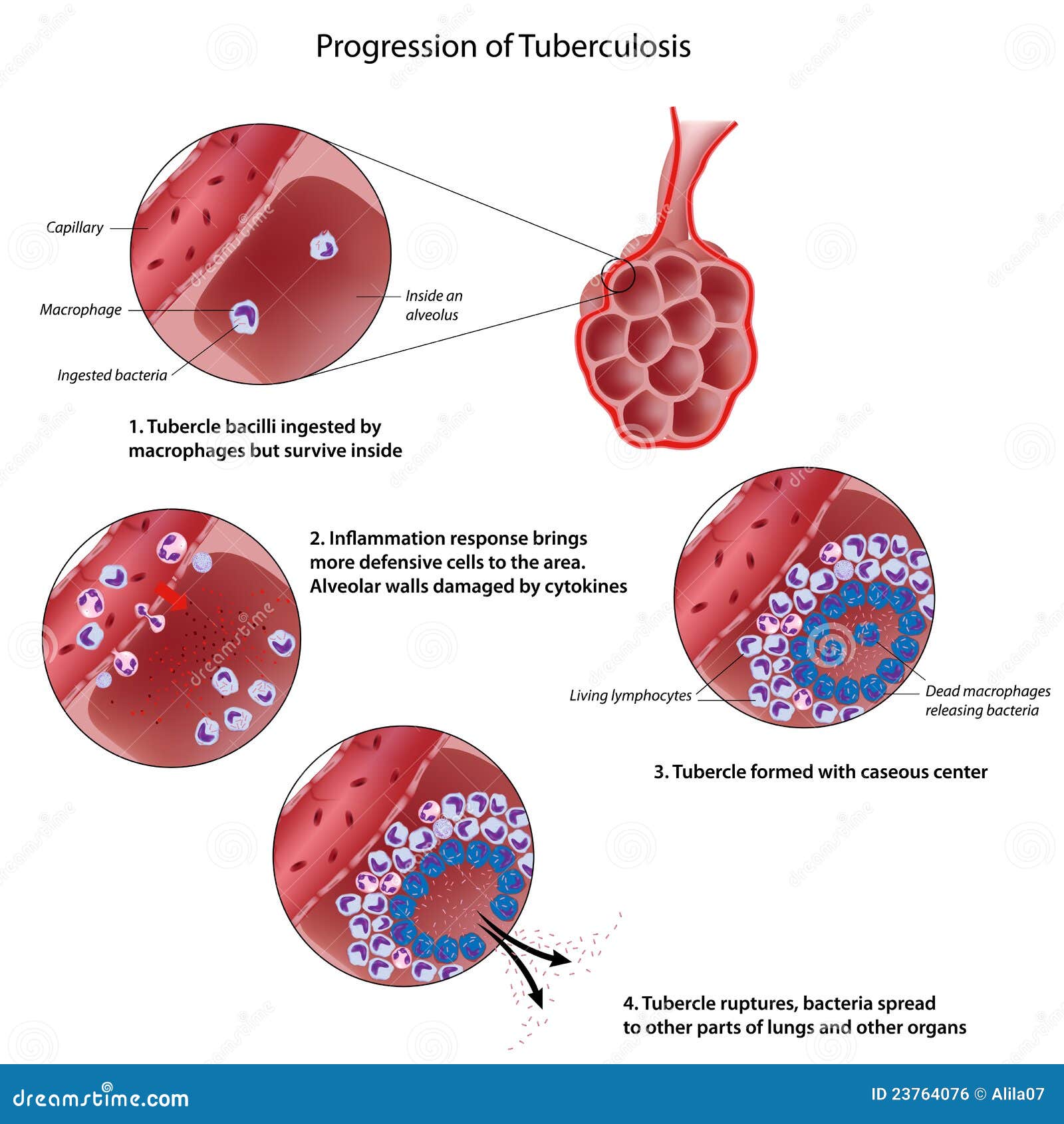 Tuberculosis Bacteria Diagram