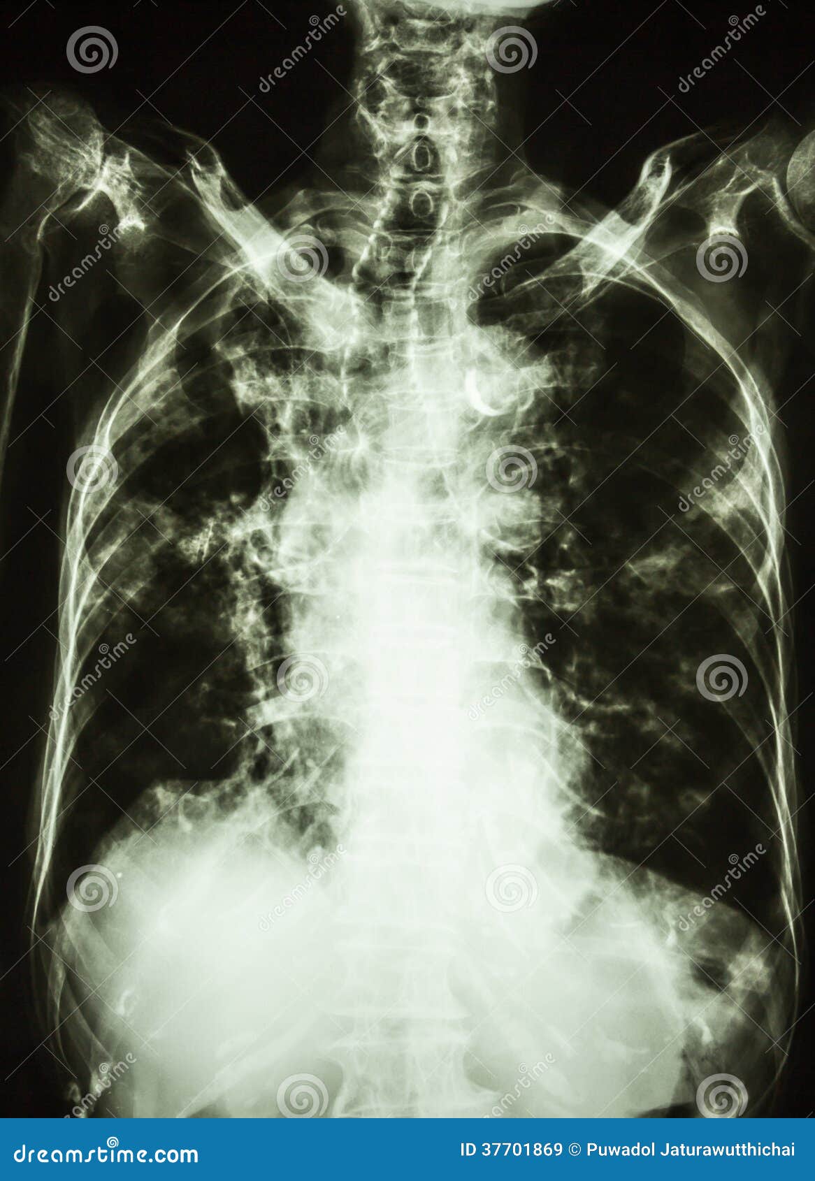 Old Dirty Film Chest Ray Stock Photos - Free & Royalty-Free Stock ...