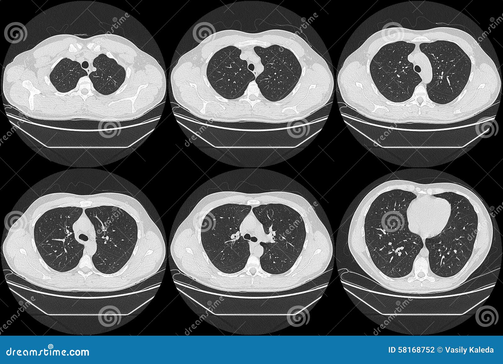 Pulmones Normales En La Tomografía Computada Foto de archivo - Imagen ...