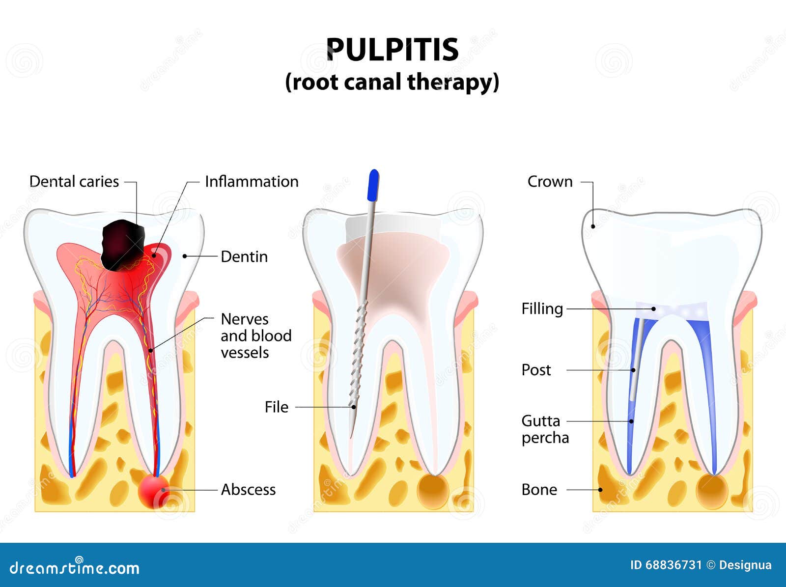 Pulpitis ilustración del vector. Ilustración de dentista - 68836731