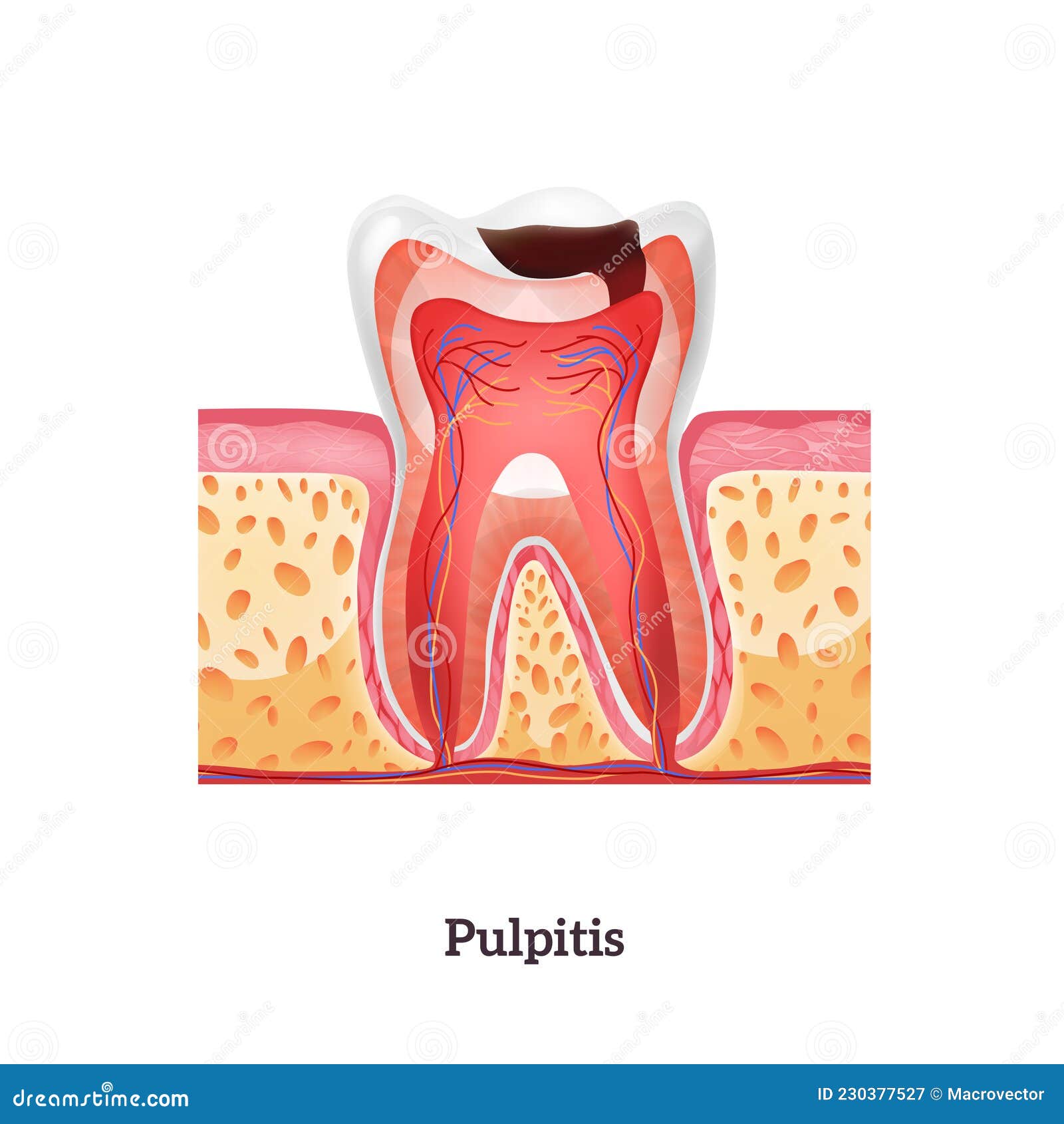 Pulpitis Realistic Illustration Stock Vector - Illustration of spot ...