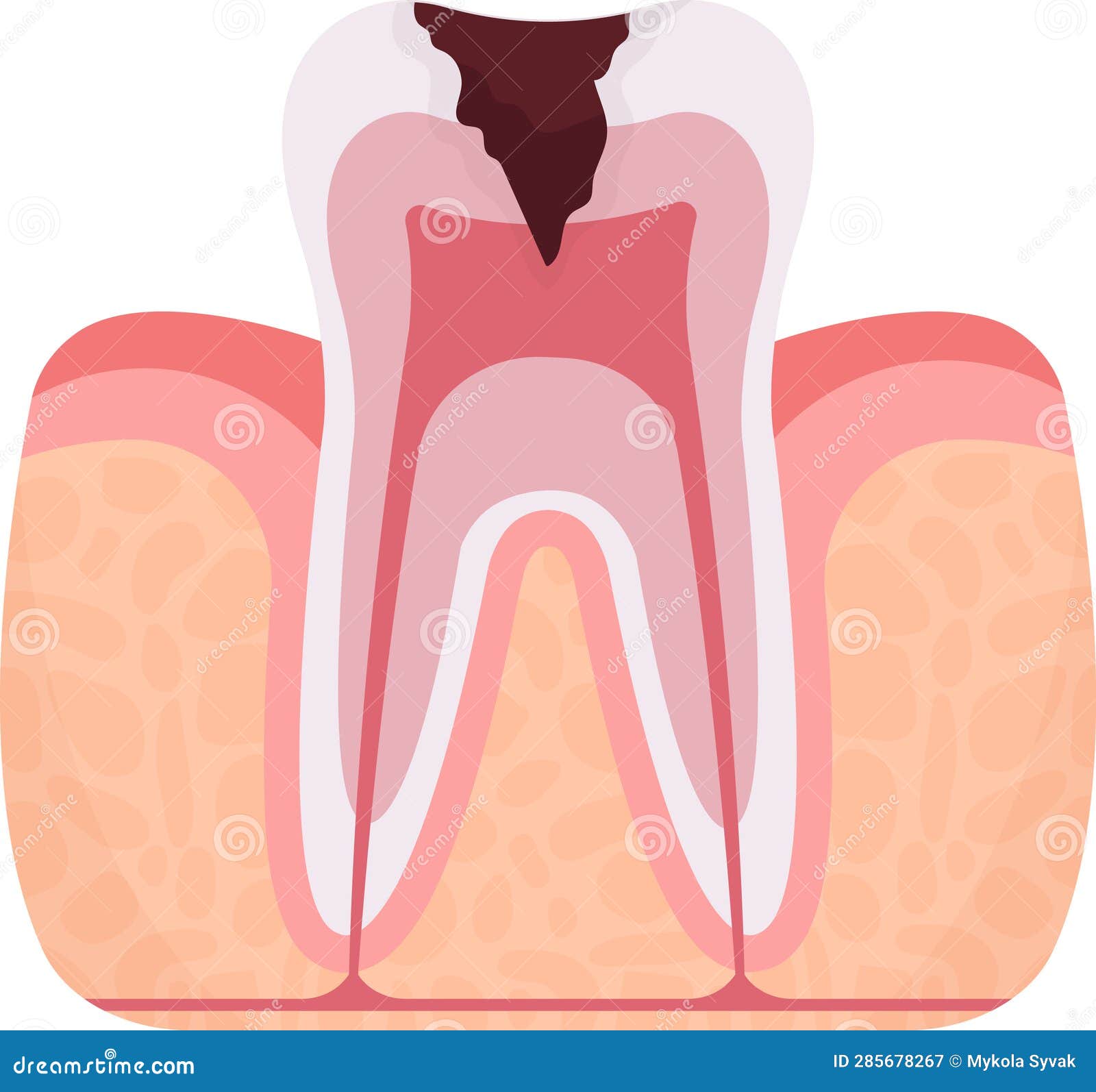 Pulpitis Tooth Problem Vector Illustration | CartoonDealer.com #285678388