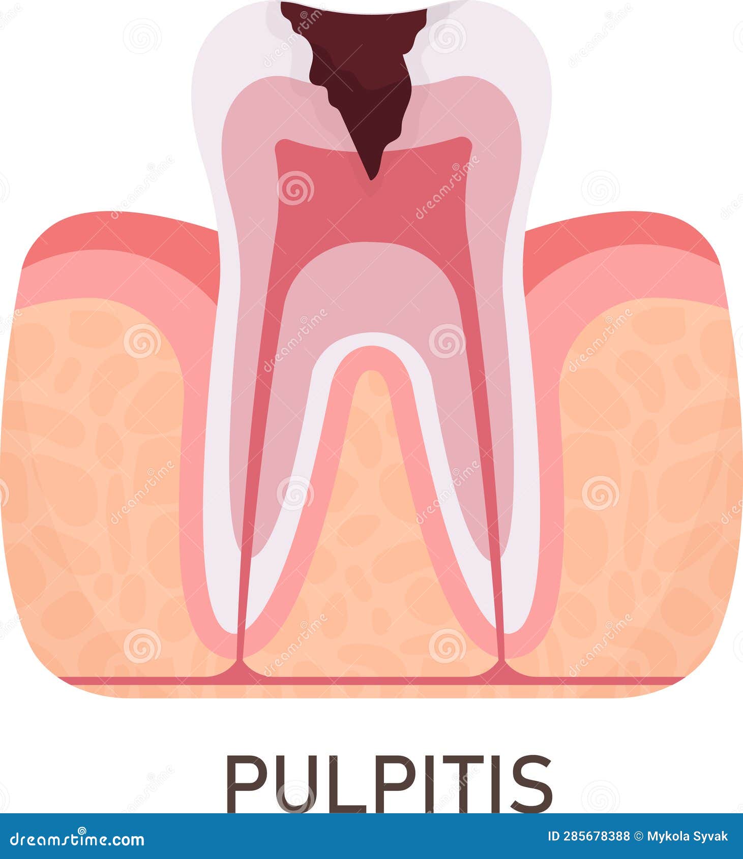 Pulpitis Tooth Problem Vector Illustration | CartoonDealer.com #285678388