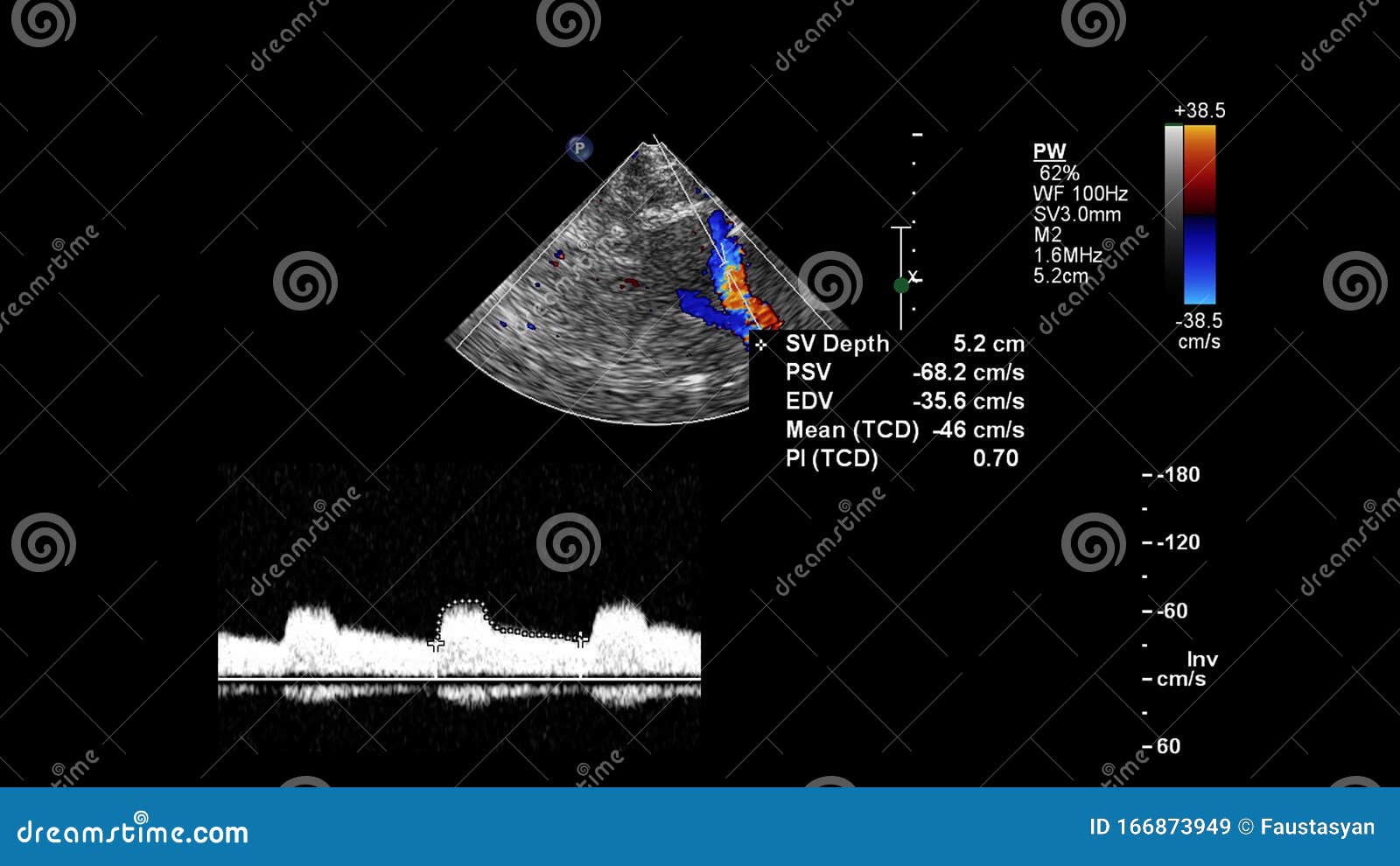Pulse Wave Doppler Ultrasound Examination. Stock Image - Image of ...