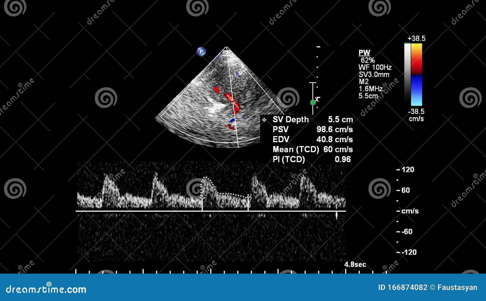 Pulse Wave Doppler Ultrasound Examination. Stock Photo - Image of ...