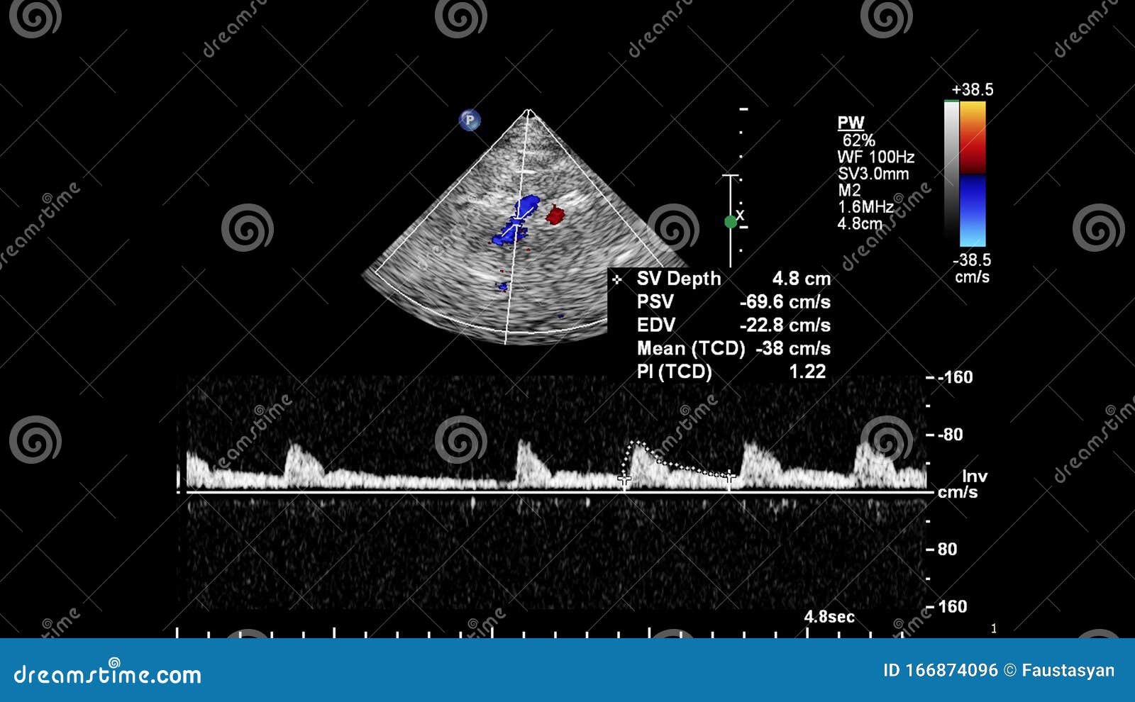 Pulse Wave Doppler Ultrasound Examination. Stock Photo - Image of ...
