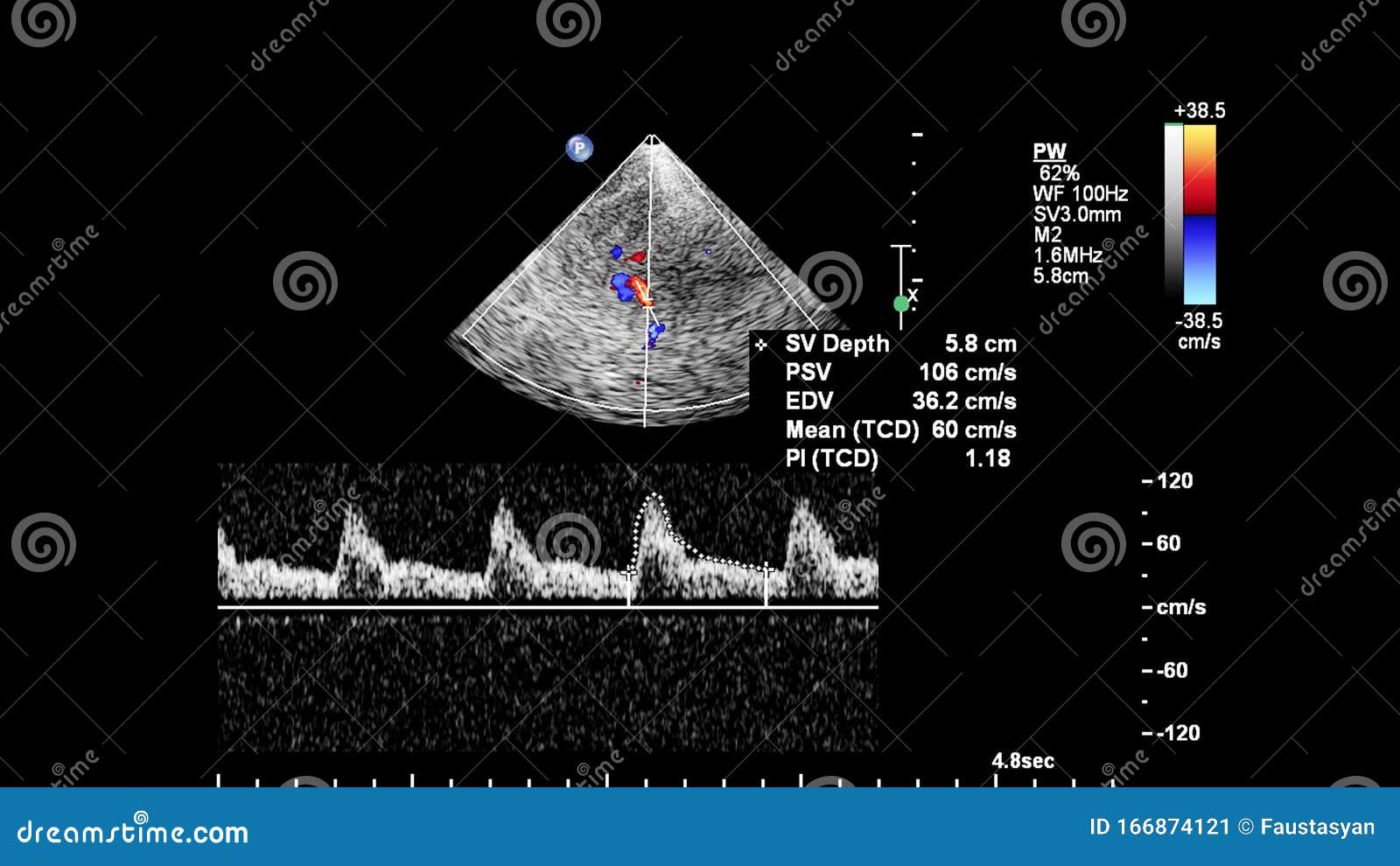 Pulse Wave Doppler Ultrasound Examination. Stock Image - Image of ...