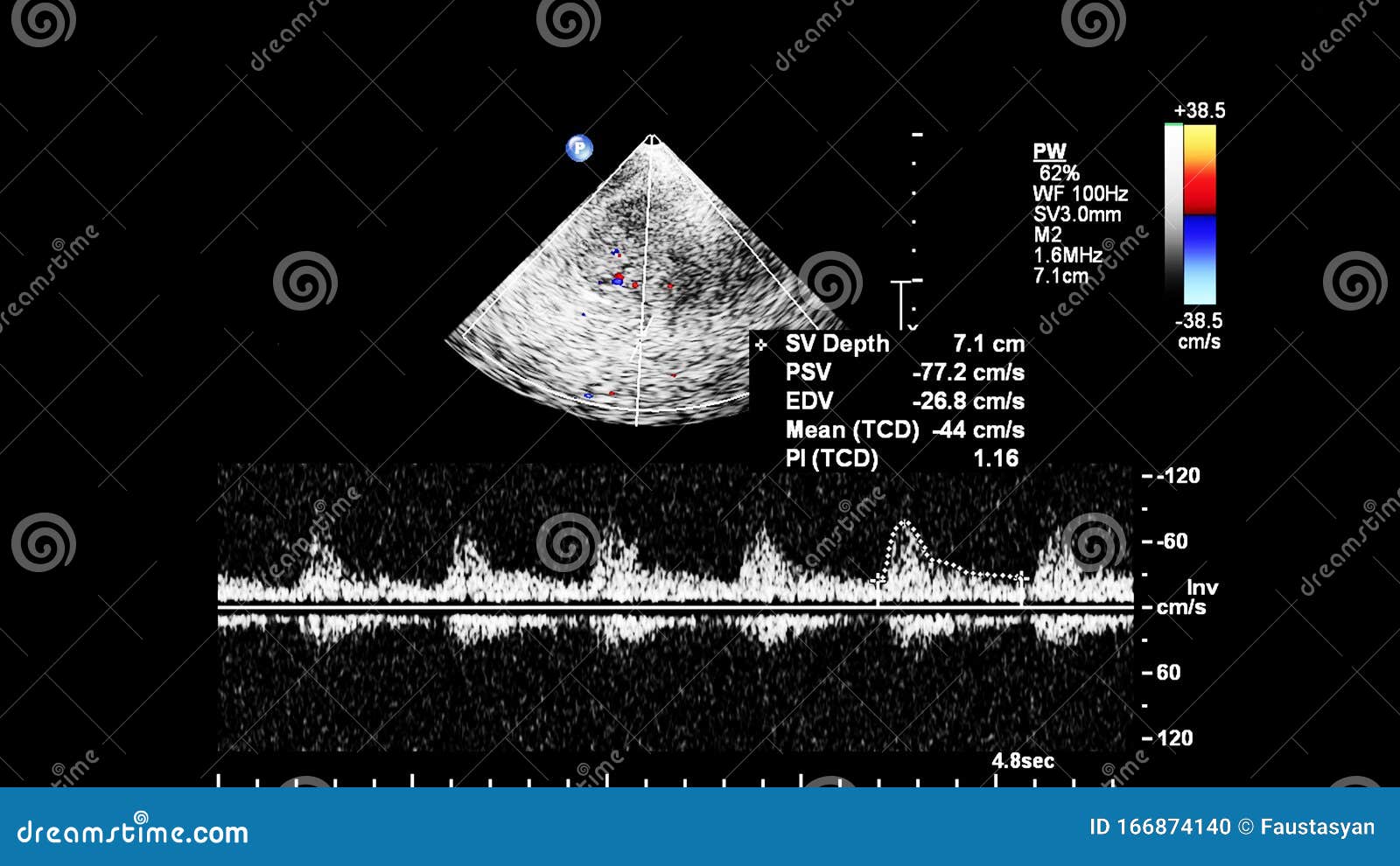 Pulse Wave Doppler Ultrasound Examination. Stock Photo - Image of ...