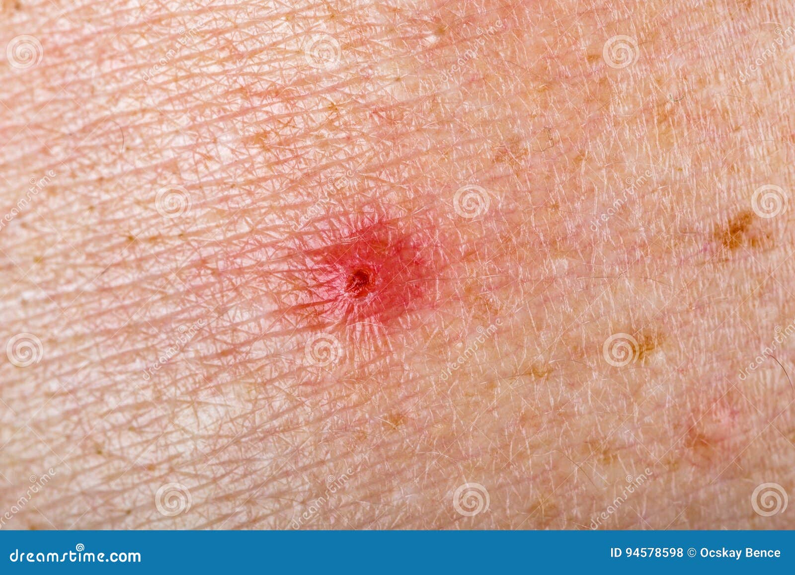 Punto Rojo Inflamado En Piel Foto de archivo - Imagen de cuidado ...