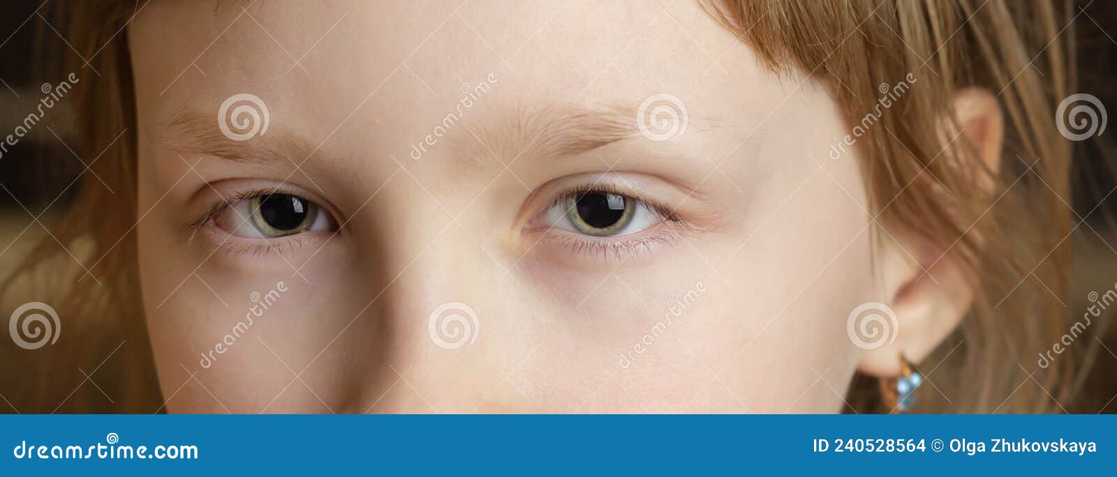 Pupil Dilation in a Child. Myopia Stock Photo - Image of connection ...