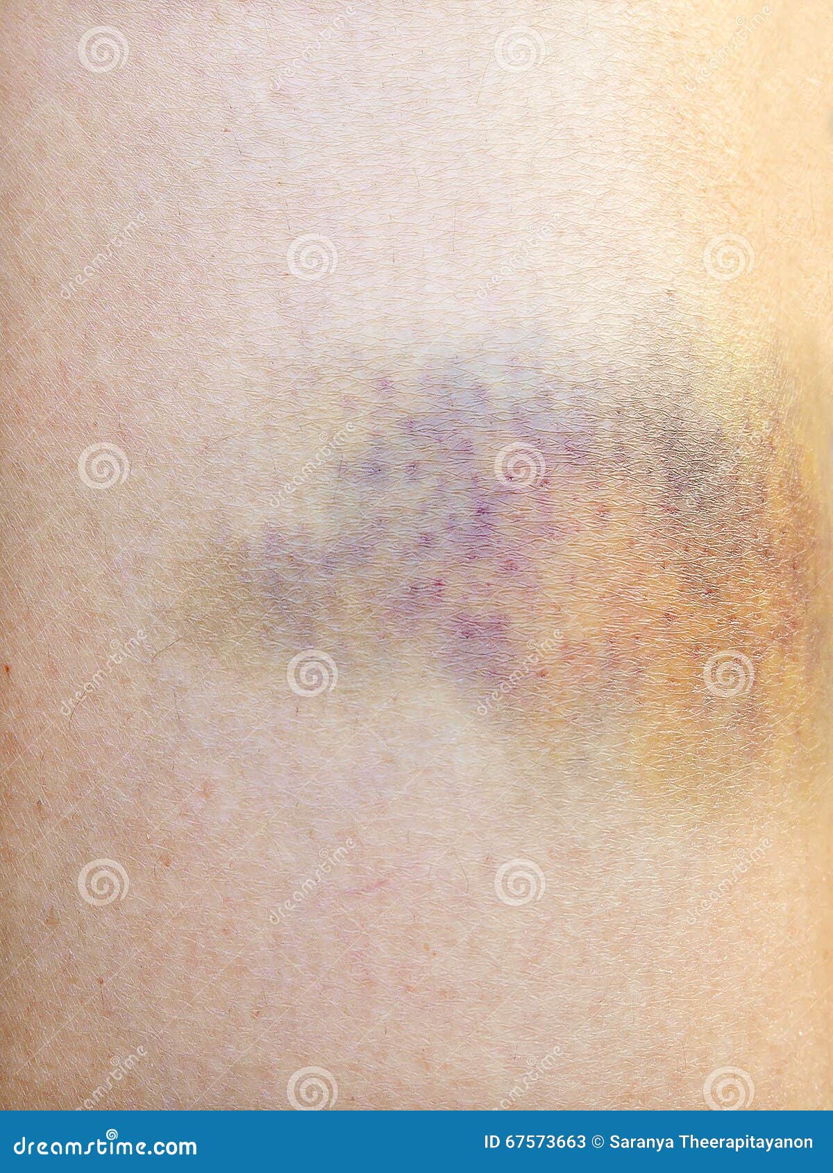 Purple bruise stock image. Image of violence, purple - 67573663