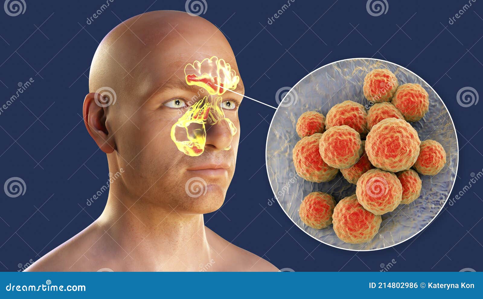 Purulent Inflammation of Frontal, Maxillary, and Ethmoid Sinuses and ...