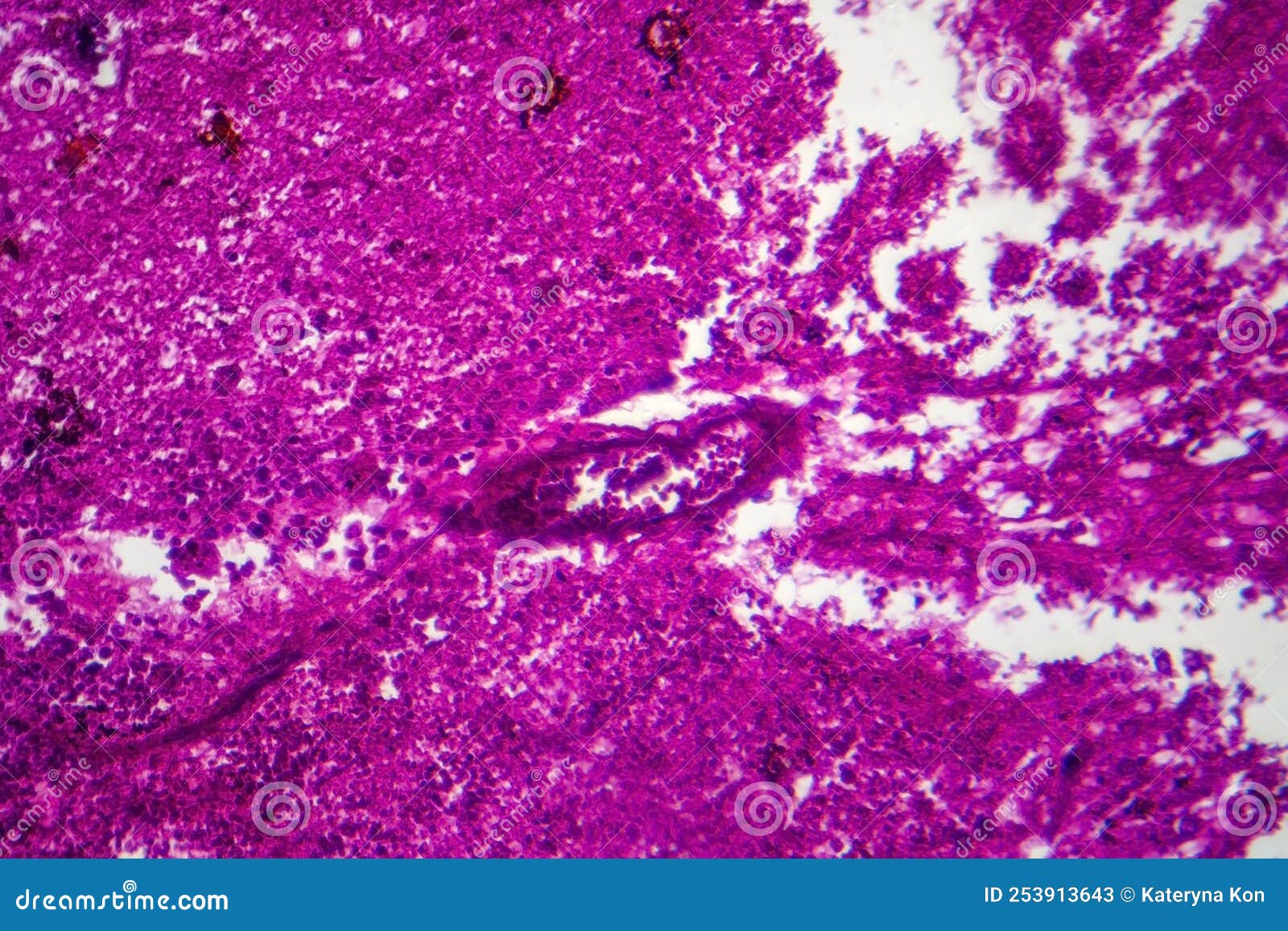 Purulent Meningitis, Light Micrograph Stock Image - Image of meningitis ...
