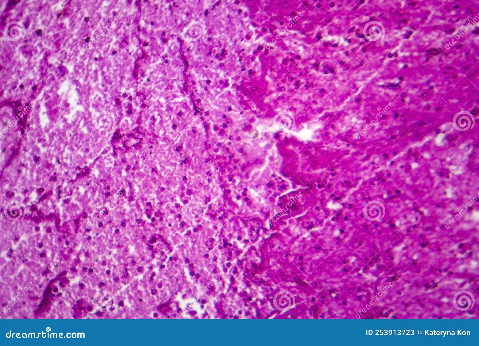 Purulent Meningitis, Light Micrograph Stock Photo | CartoonDealer.com ...
