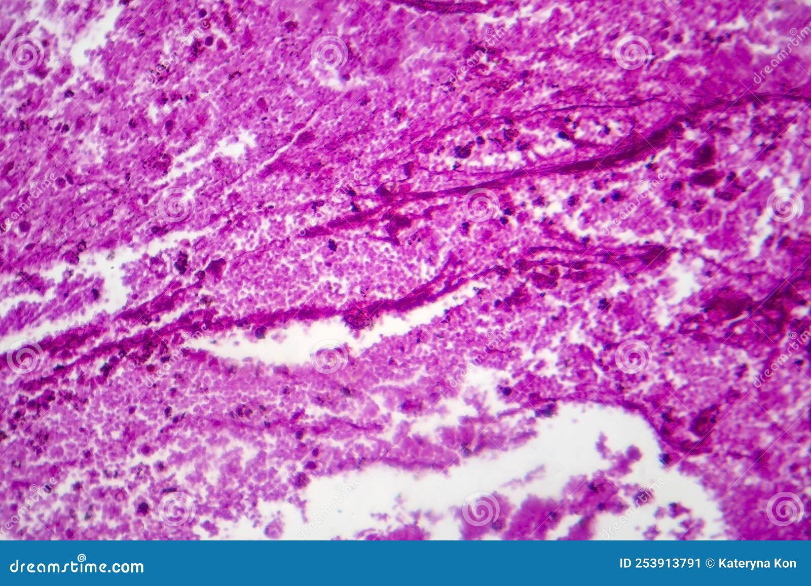 Purulent Meningitis, Light Micrograph Stock Photo | CartoonDealer.com ...