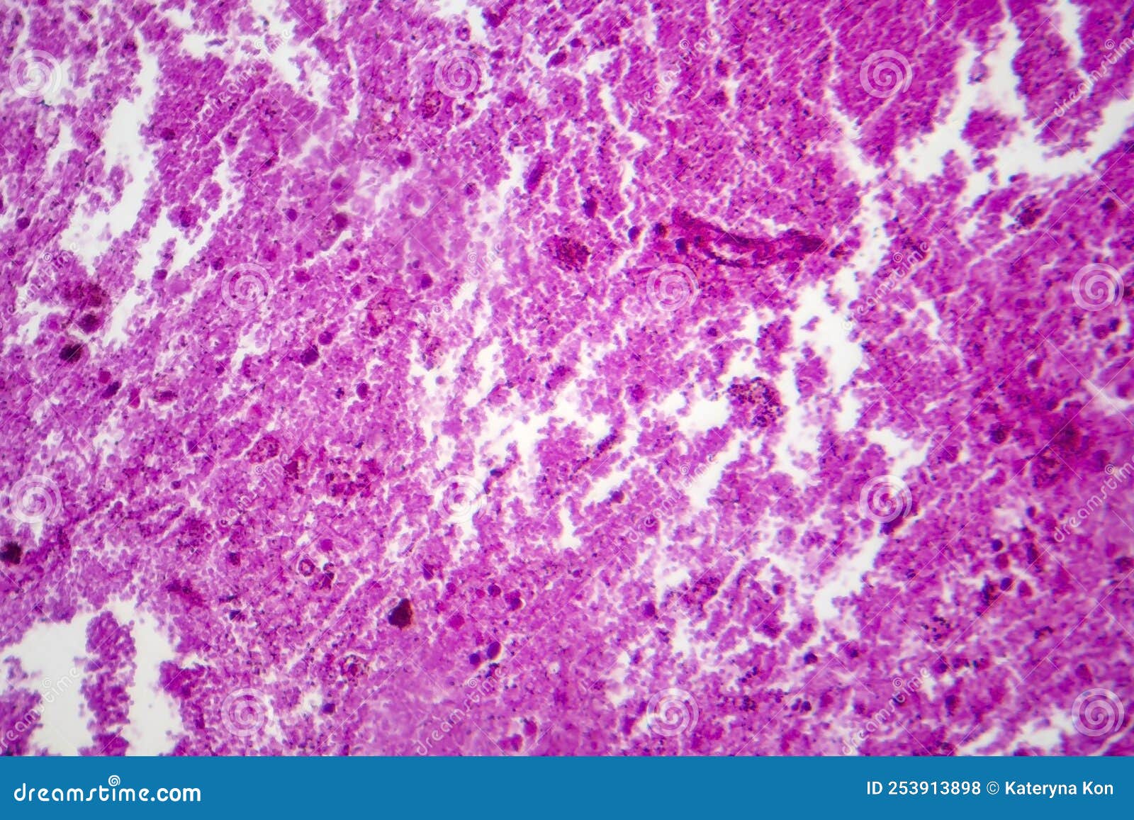 Purulent Meningitis, Light Micrograph Stock Photo - Image of neisseria ...