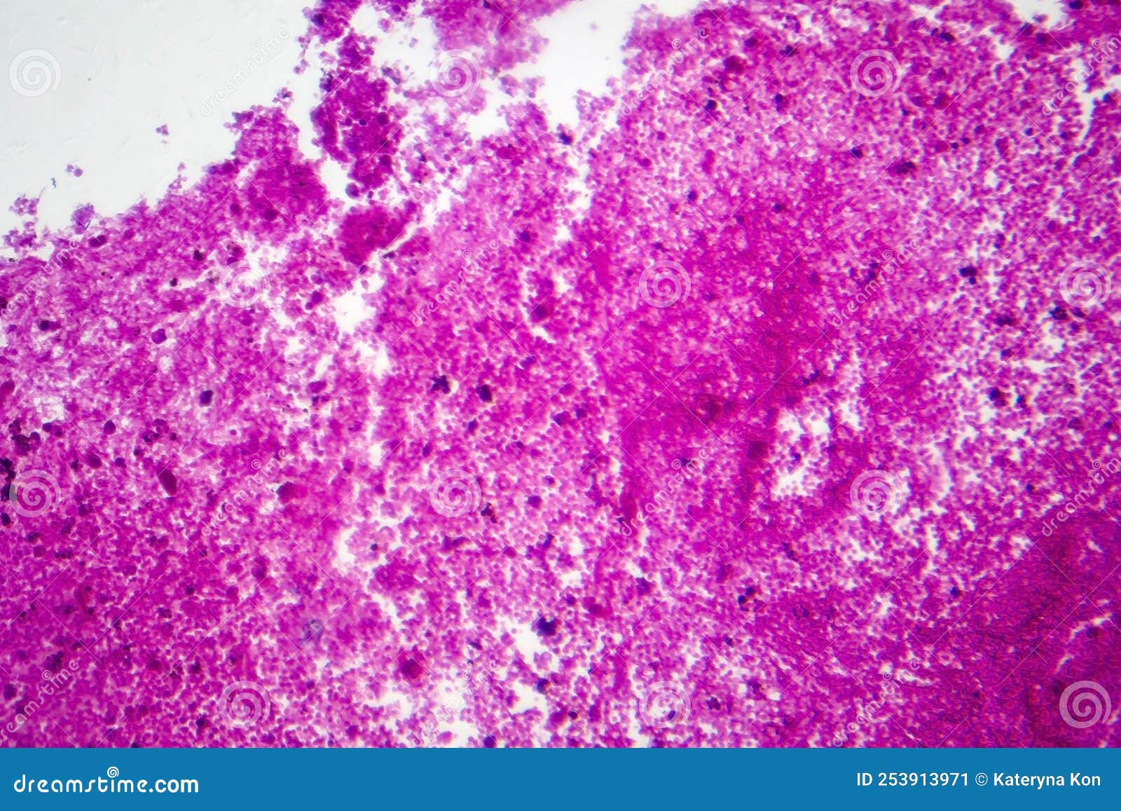 Purulent Meningitis, Light Micrograph Stock Image - Image of illness ...