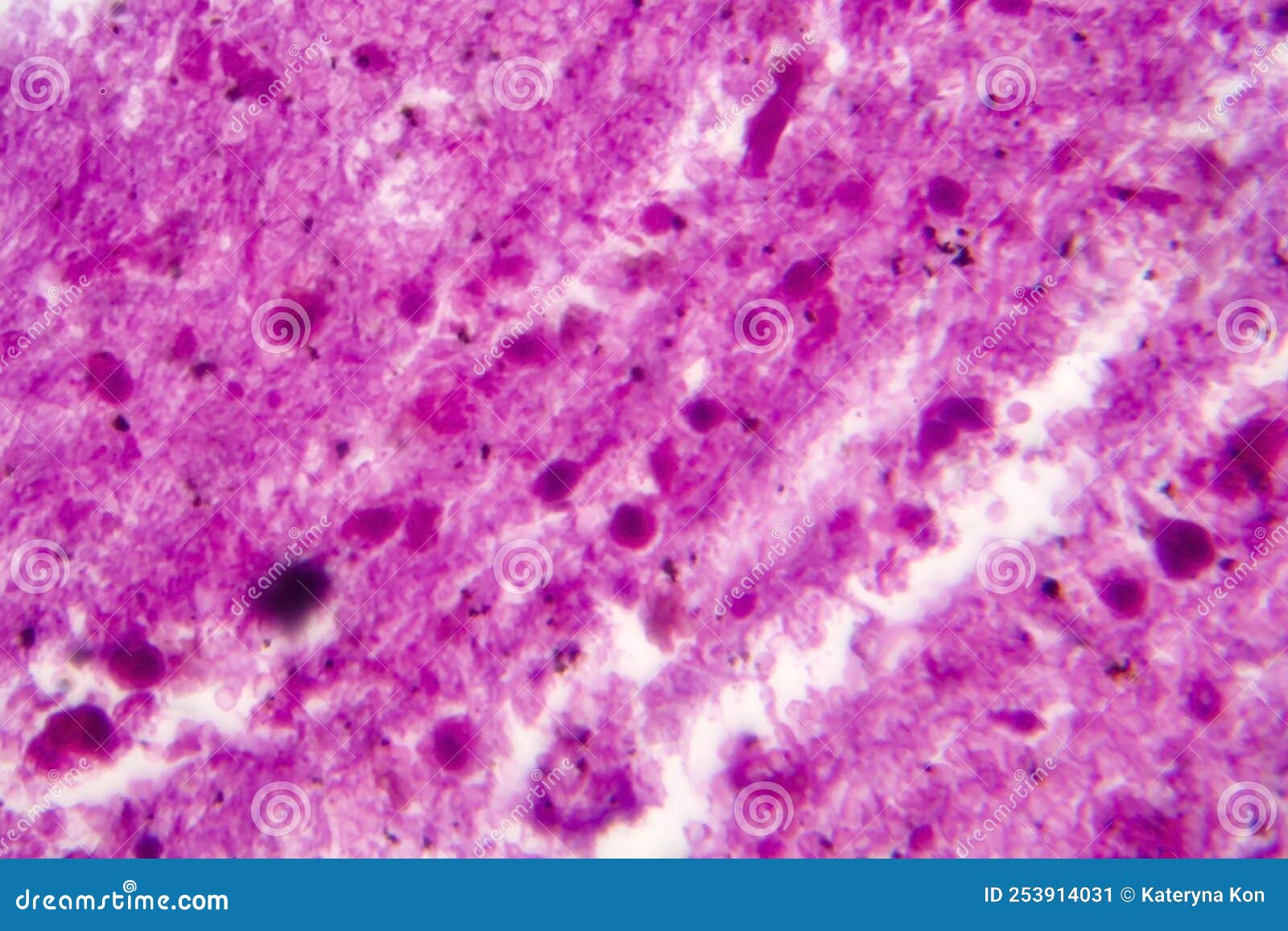 Purulent Meningitis, Light Micrograph Stock Image | CartoonDealer.com ...