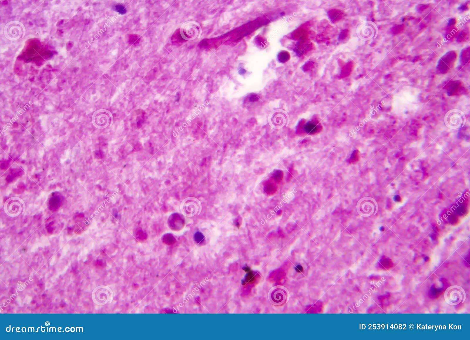 Purulent Meningitis, Light Micrograph Stock Photo - Image of tissue ...